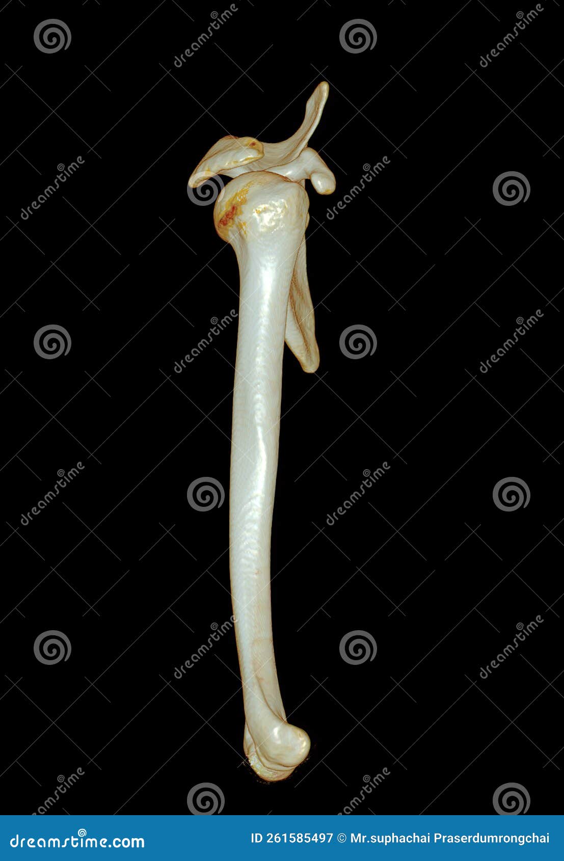 CT SCAN Of Arm 3D Rendering Isolated On Black Background Royalty-Free ...
