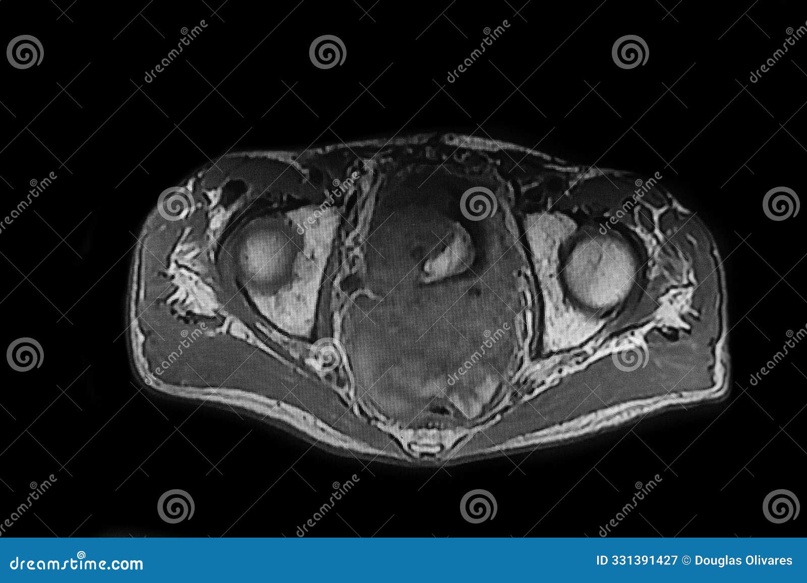 Ct Scan Of Bladder Tumor Stock Illustration Illustration Of Research 331391427