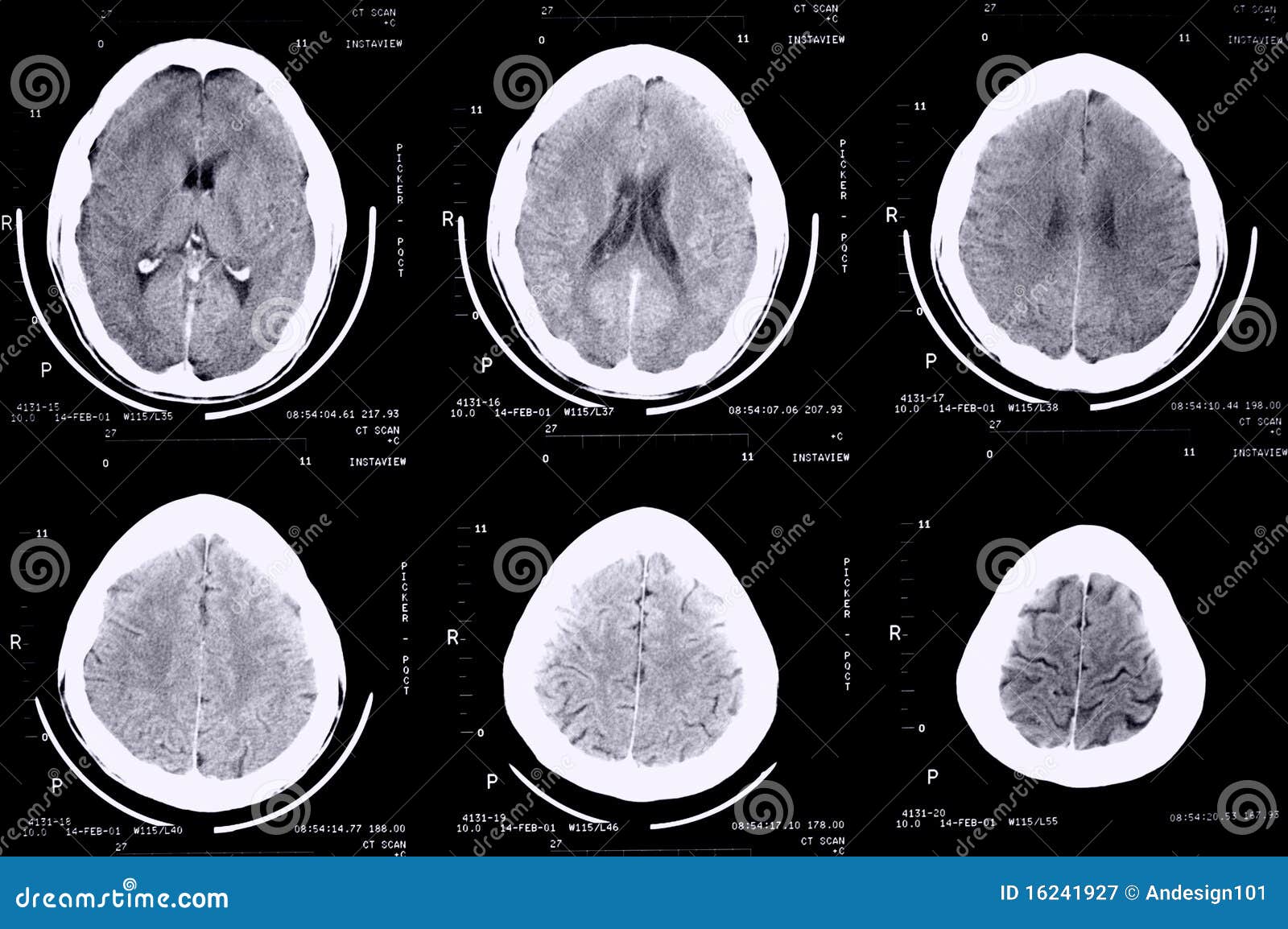 Ct scan brain stock image. Image of radiology, computed - 16241927 Ct scan brain stock image. Image of radiology, computed - 16241927