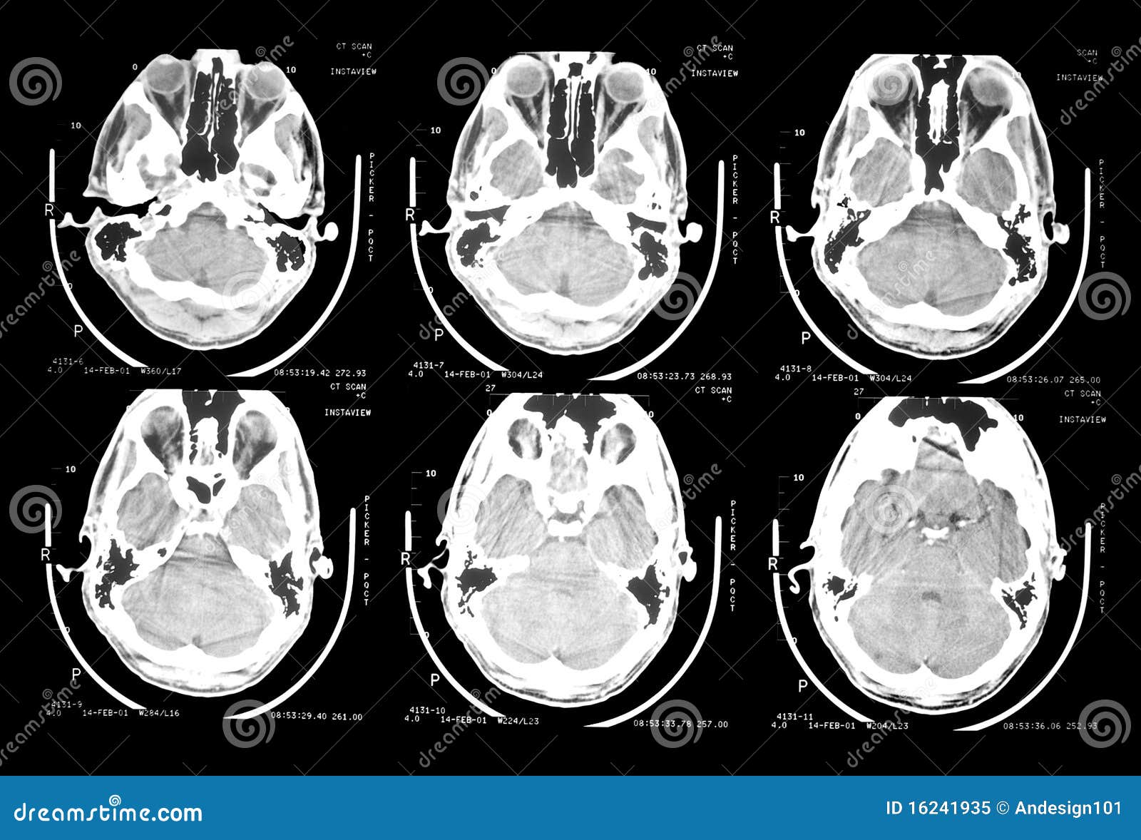 Ct scan brain stock image. Image of radiograph, radiology - 16241935