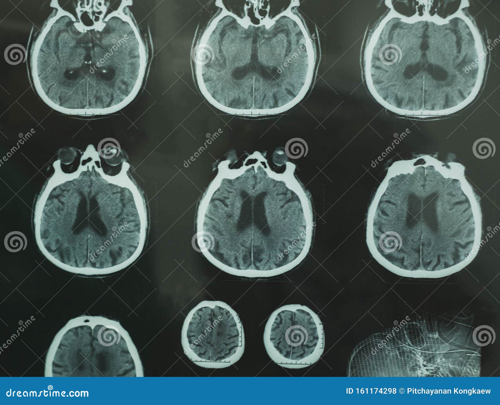 CT scan of brain stock photo. Image of accident, illness - 161174298