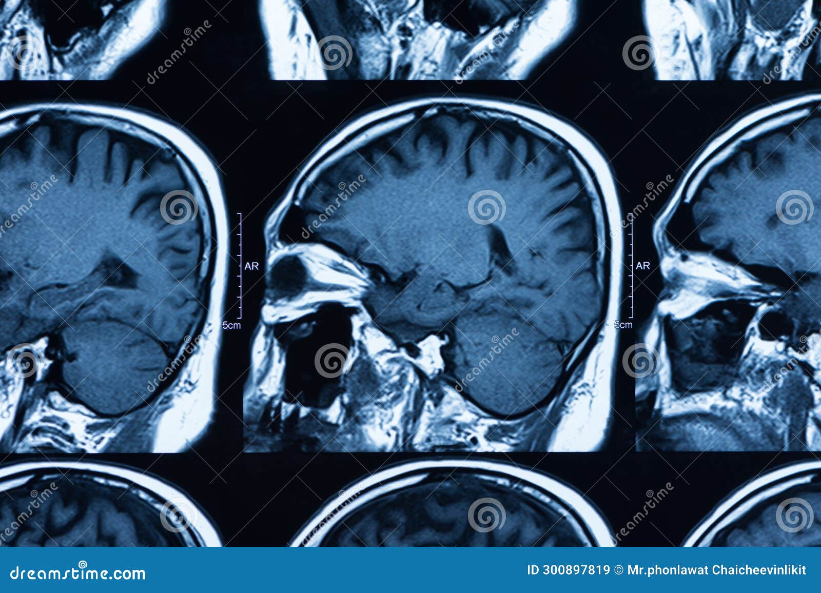 Brain ct scan stock image. Image of examination, analyzing - 300897819