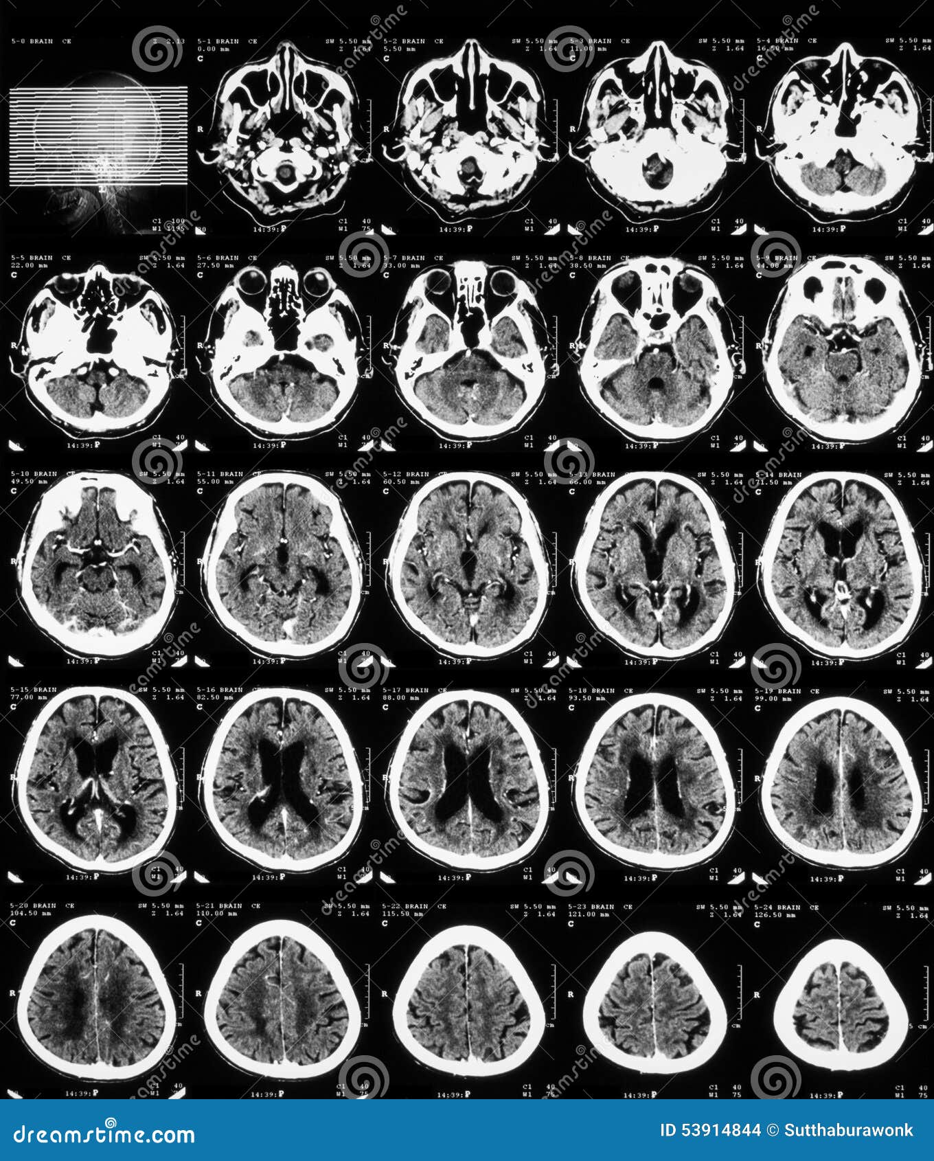 CT Scan Of Brian Stem Hemorrhage Royalty-Free Stock Photo ... CT Scan Of Brian Stem Hemorrhage Royalty-Free Stock Photo ...