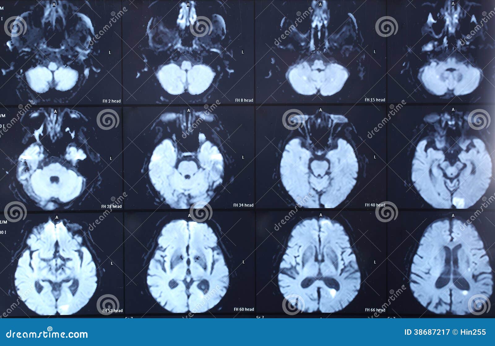 CT scan brain stock image. Image of report, result, neurons - 38687217