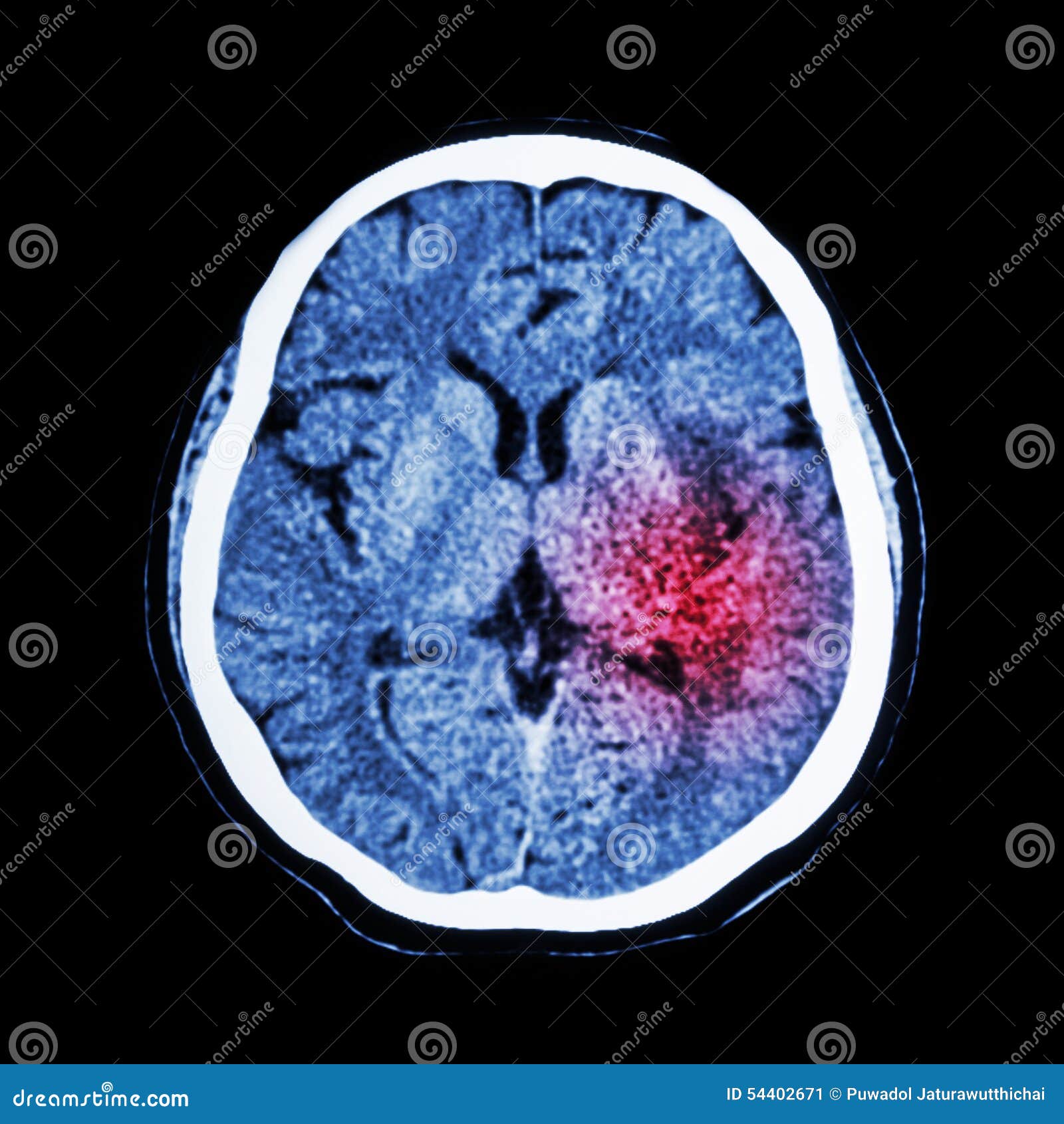 Ischemic Stroke : ( CT Of Brain Show Cerebral Infarction At Left ...