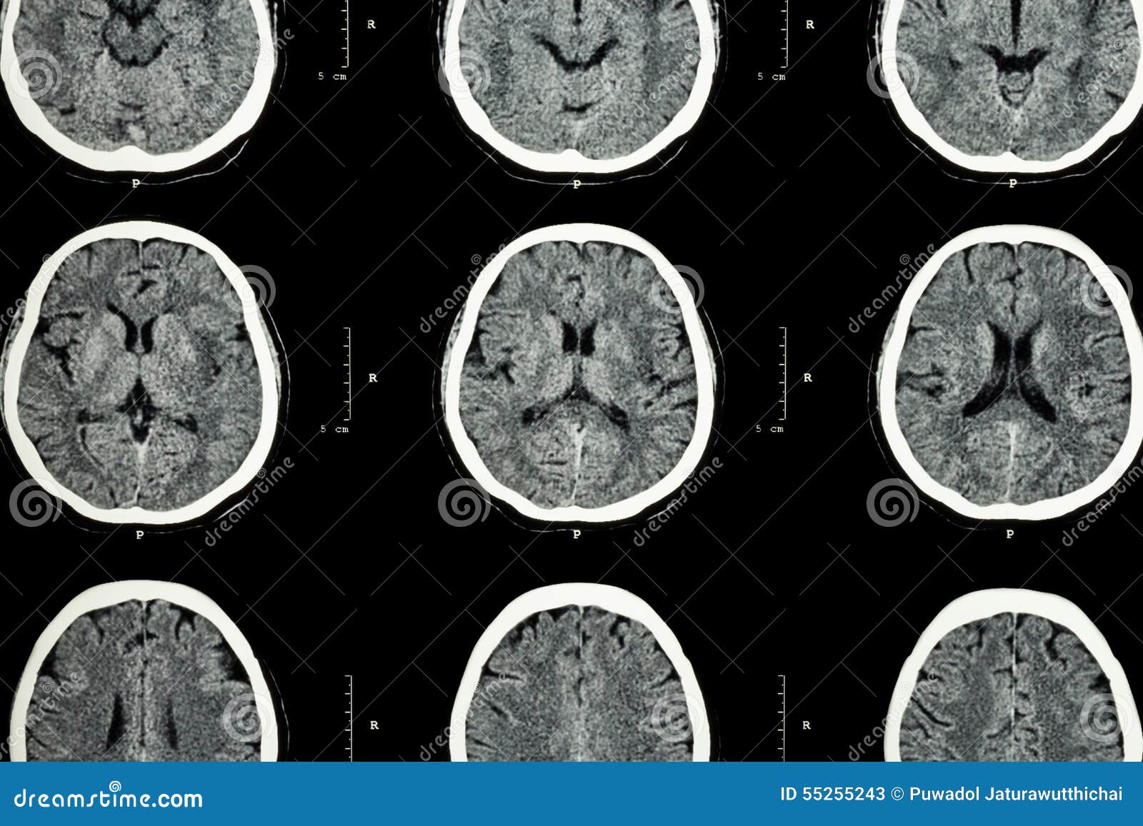 CT Scan of Brain Show Normal Brain ( Neurological Background )CT Scan ... CT Scan of Brain Show Normal Brain ( Neurological Background )CT Scan ...