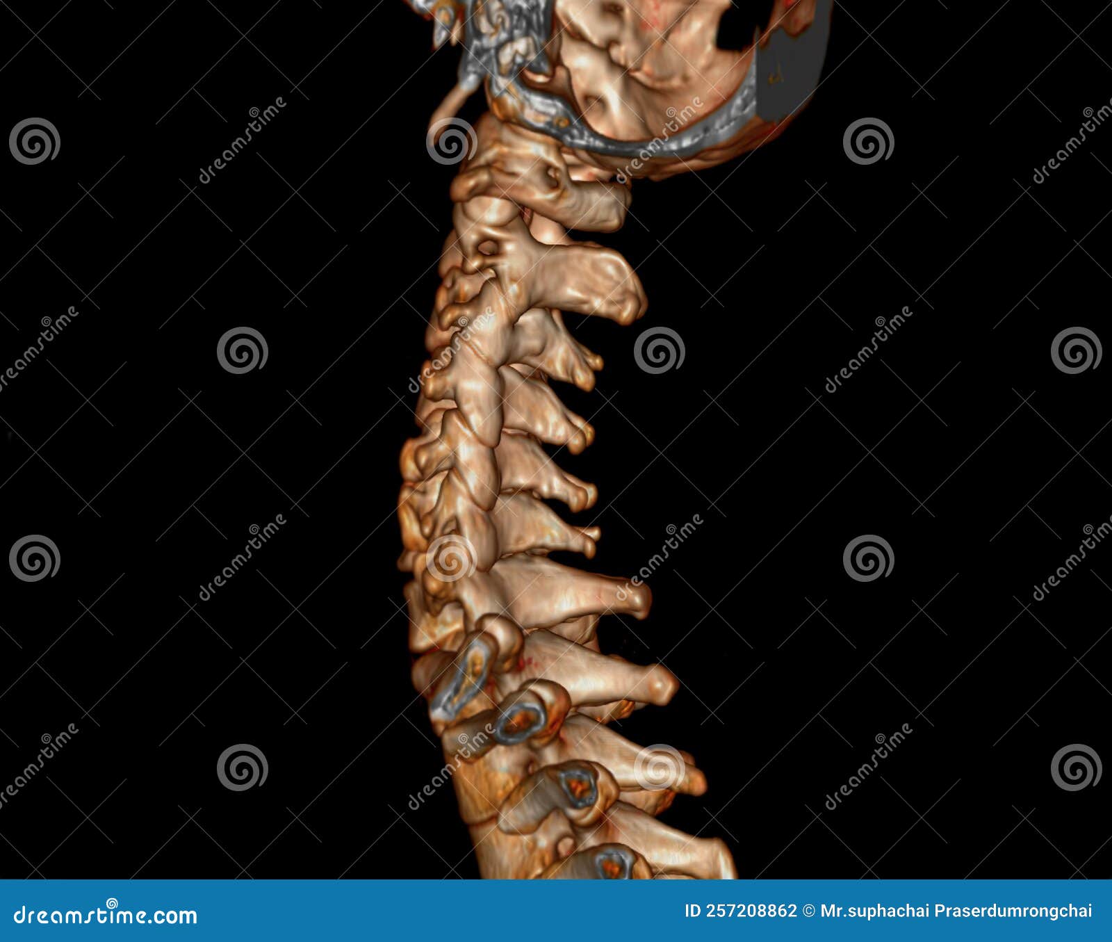 Cervical Fracture And Human Spine And Vertebrae Damage Outline Diagram ...