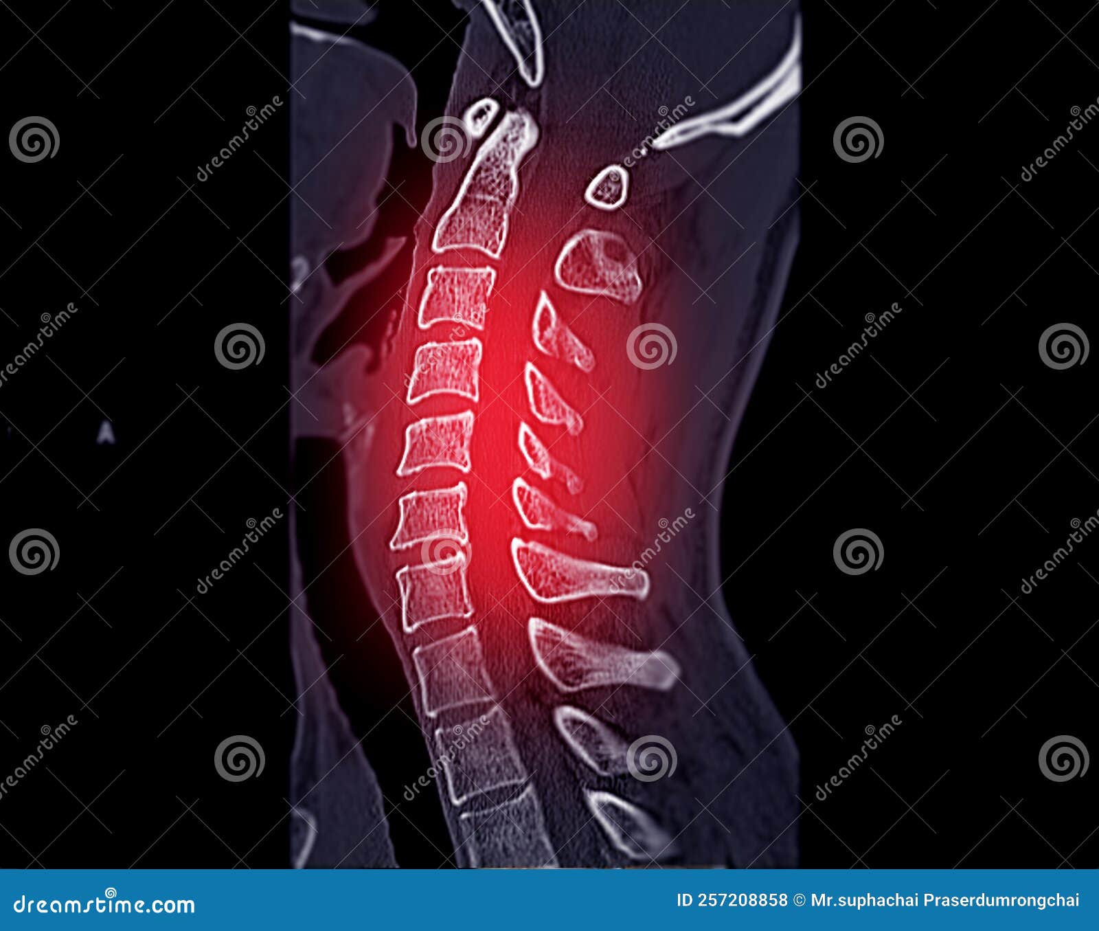 CT Scan of C-Spine or Cervical Spine Stock Illustration - Illustration ... CT Scan of C-Spine or Cervical Spine Stock Illustration - Illustration ...
