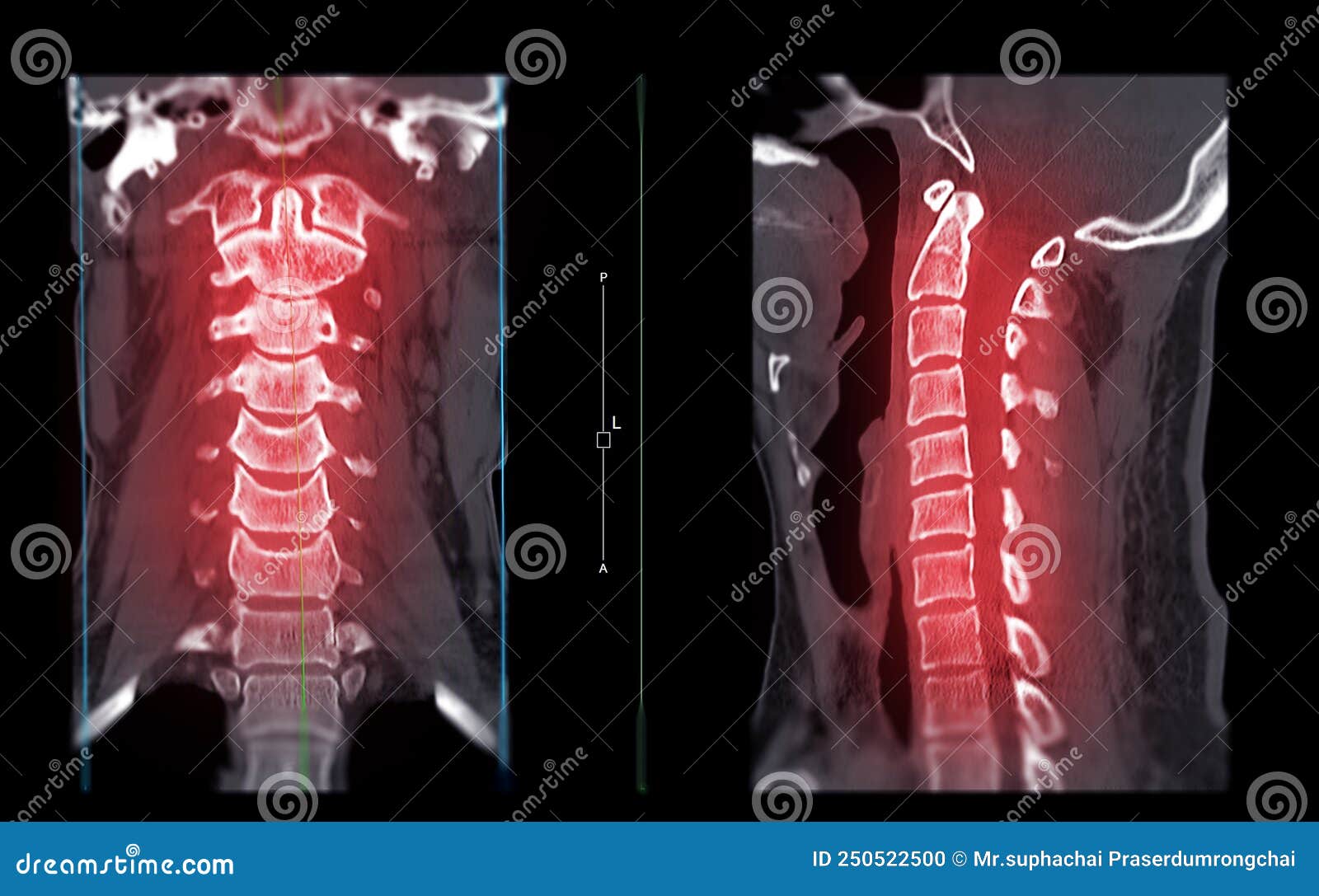 CT SCAN of Cervical Spine C-spine Stock Illustration - Illustration of ... CT SCAN of Cervical Spine C-spine Stock Illustration - Illustration of ...