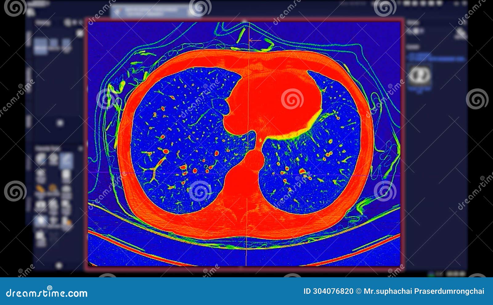 Ct Scan Of Chest Axial View In Color Mode For Diagnostic Pulmonary