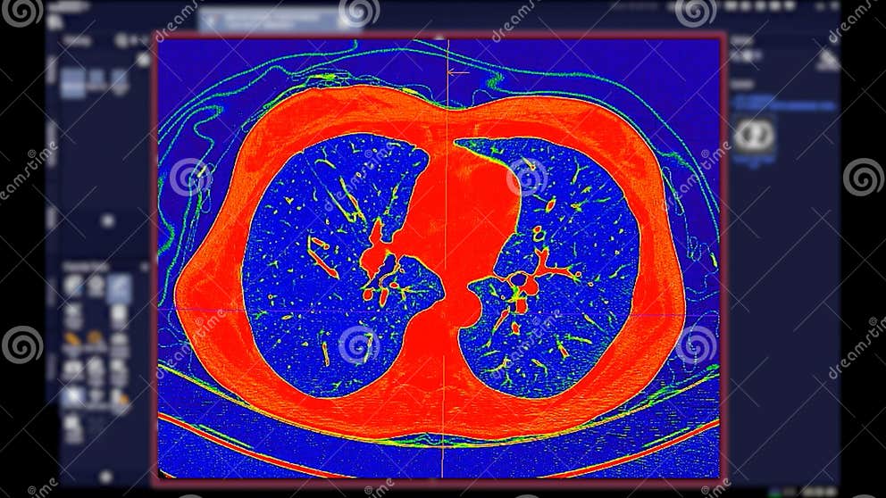 Ct Scan Of Chest Axial View In Color Mode For Diagnostic Pulmonary Embolism Pe Lung Cancer