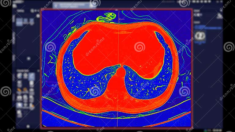 Ct Scan Of Chest Axial View In Color Mode For Diagnostic Pulmonary Embolism Pe Lung Cancer