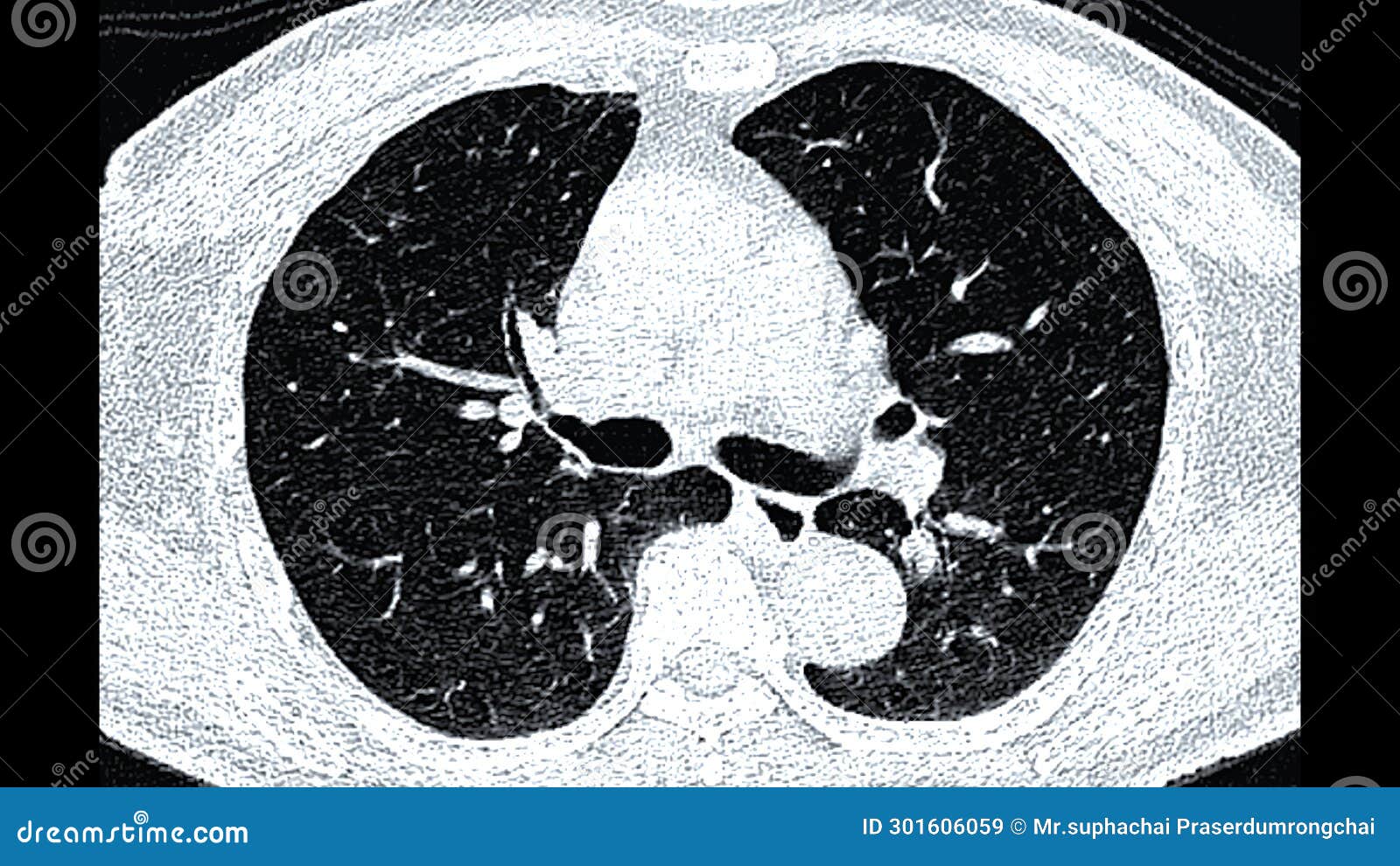 Ct Scan Of Chest Or Lung Axial View For Screening Lung Nodules Stock