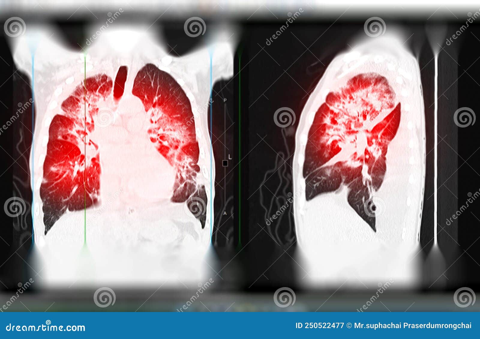 CT Scan Of Chest, Vector Illustration. X-ray Computed Tomography Test ...