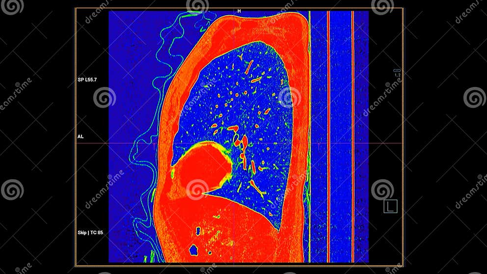 Ct Scan Of Chest Sagittal View In Color Mode For Diagnostic Pulmonary Embolism Pe Lung