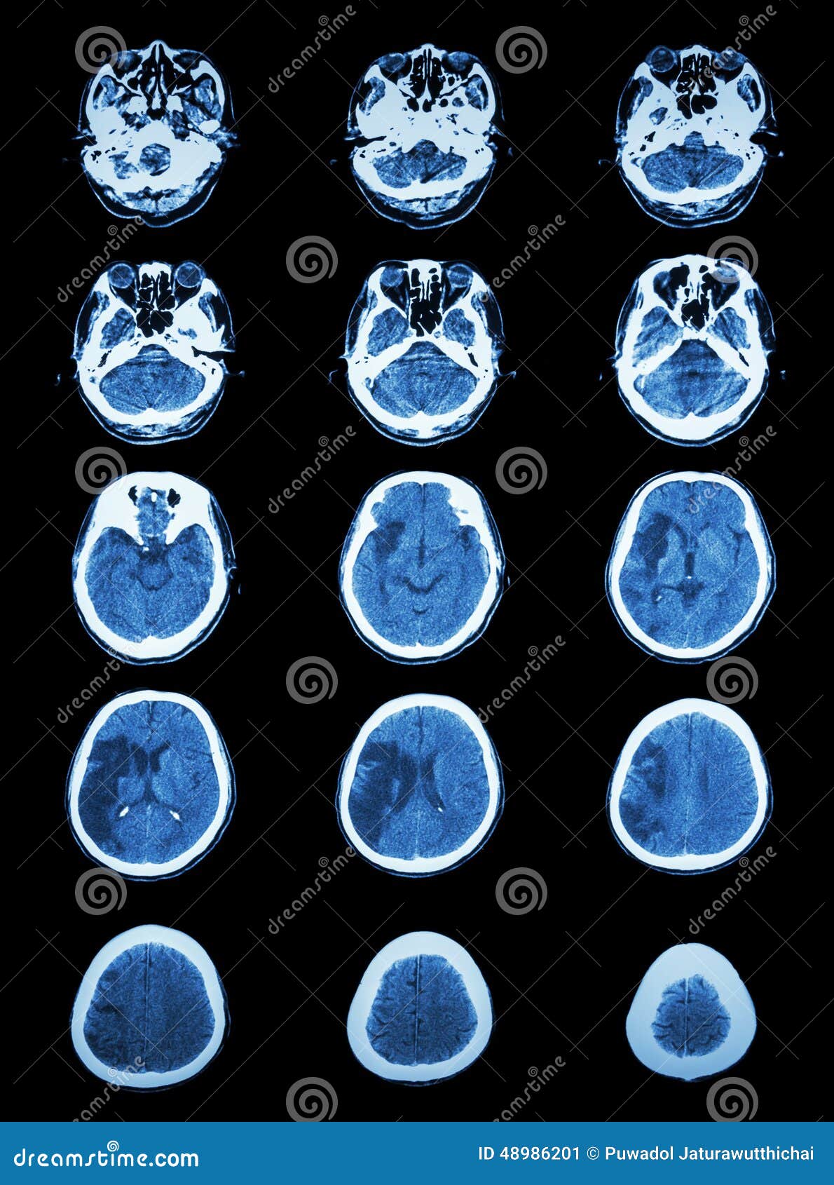 CT Scan (computed Tomography) of Brain Show Cerebral Infarction Stock ... CT Scan (computed Tomography) of Brain Show Cerebral Infarction Stock ...