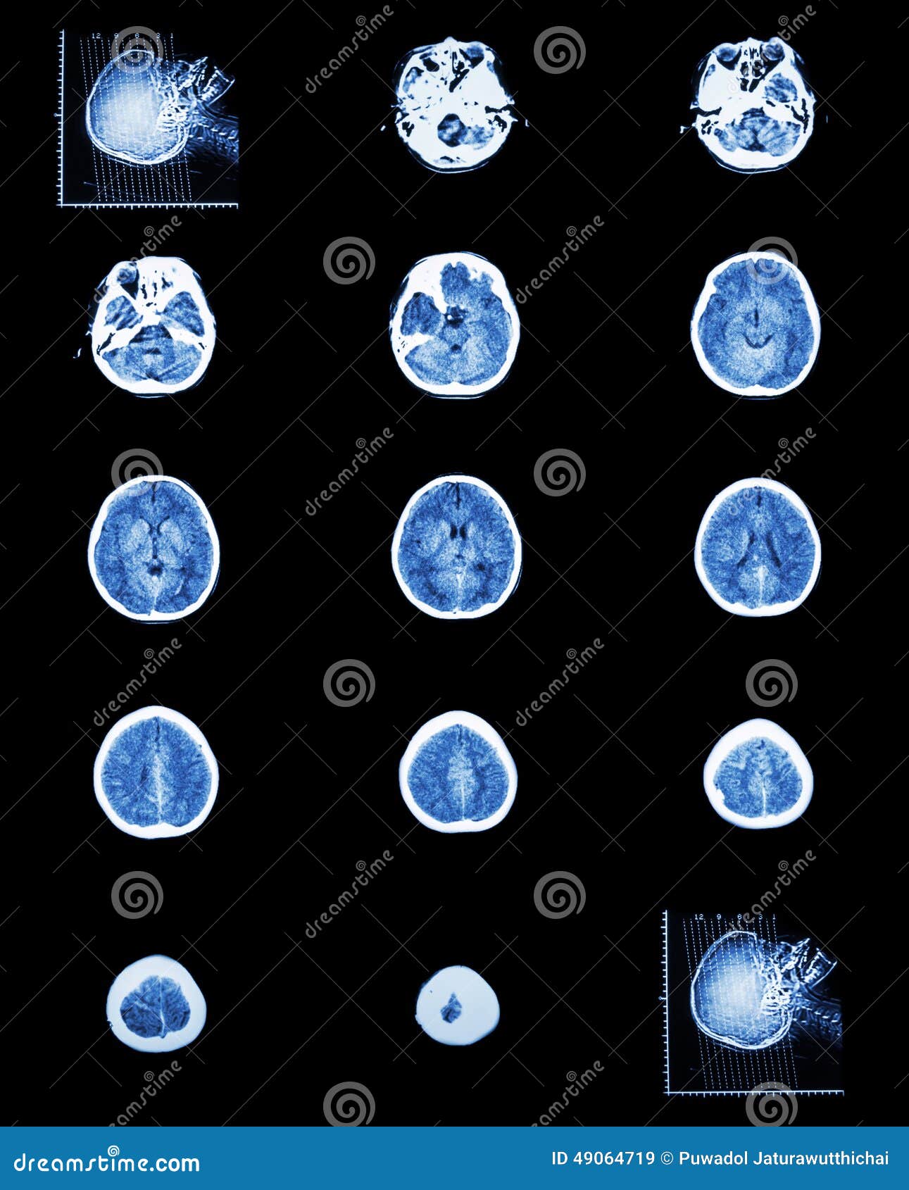 CT Scan (computed Tomography) of Normal Brain ( Cerebrovascular Stock ...