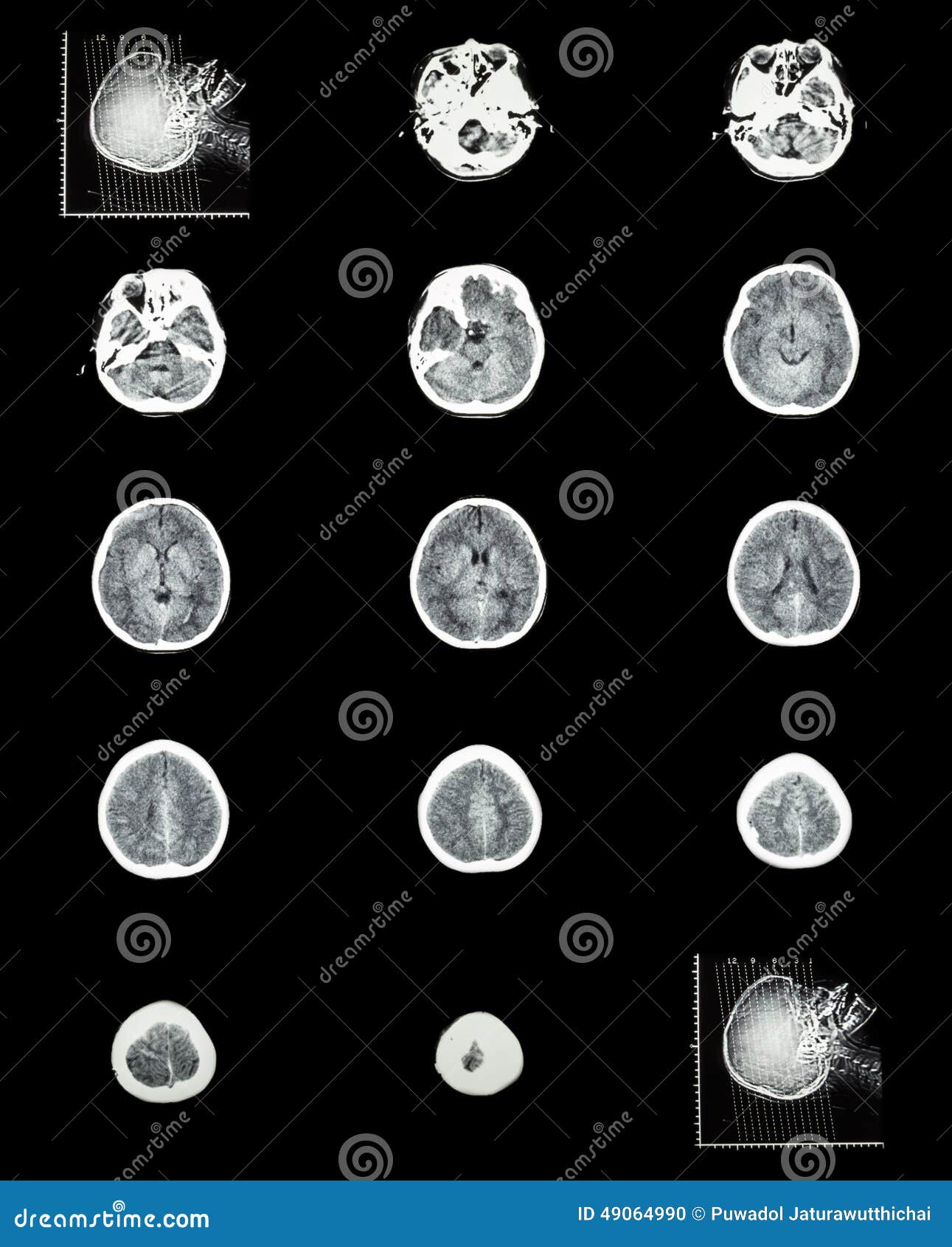CT Scan (computed Tomography) Of Normal Brain ( Cerebrovascular Stock ...