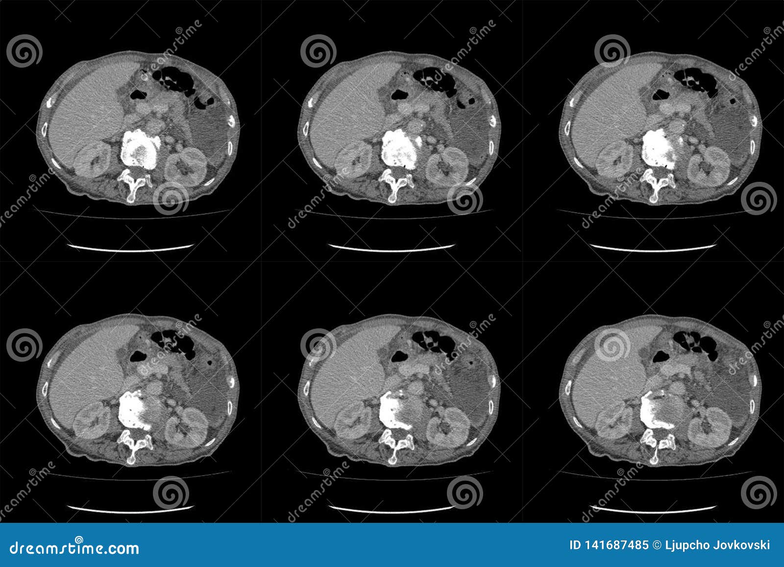 Computed Tomography Ct Whole Abdomen In Axial Part Eighteen Stock