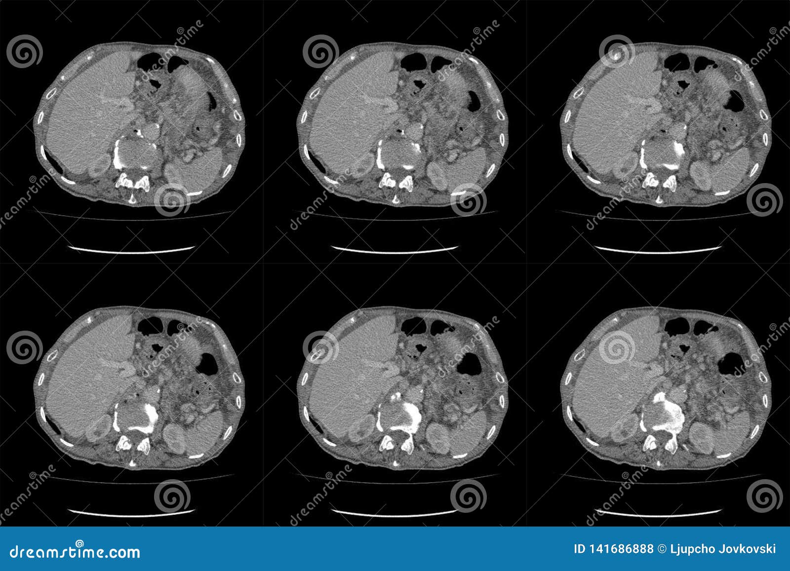 Computed Tomography CT Whole Abdomen in Axial. Part Twelve Stock Photo ... Computed Tomography CT Whole Abdomen in Axial. Part Twelve Stock Photo ...