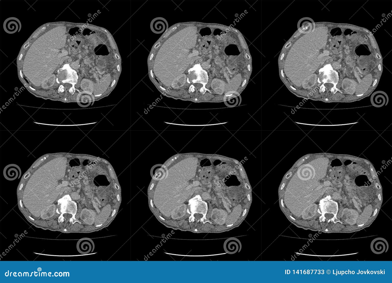 Computed Tomography Ct Whole Abdomen In Axial Part Thirteen Stock