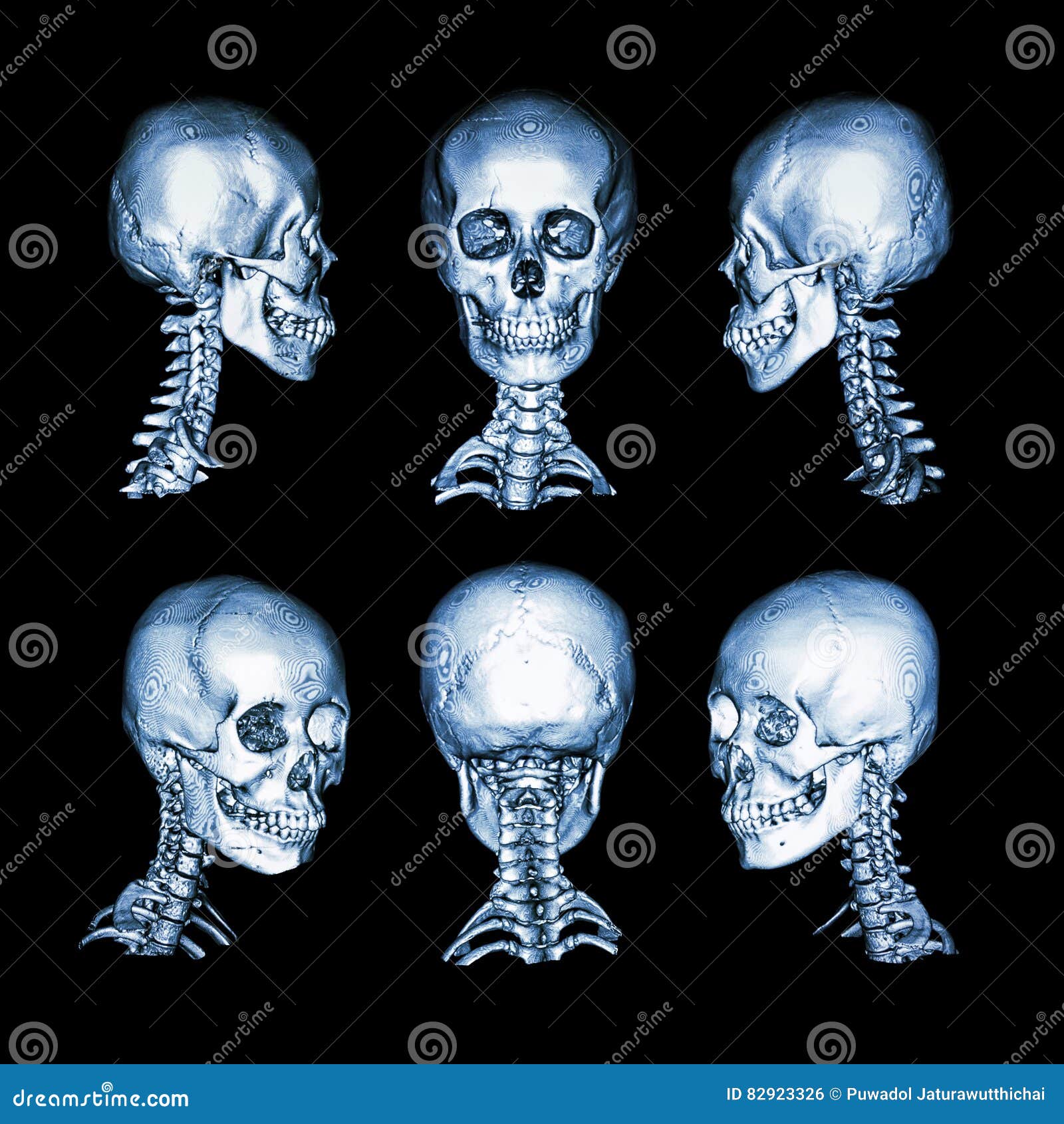 CT Scan and 3D Image . Normal Human Skull and Cervical Spine .all ...