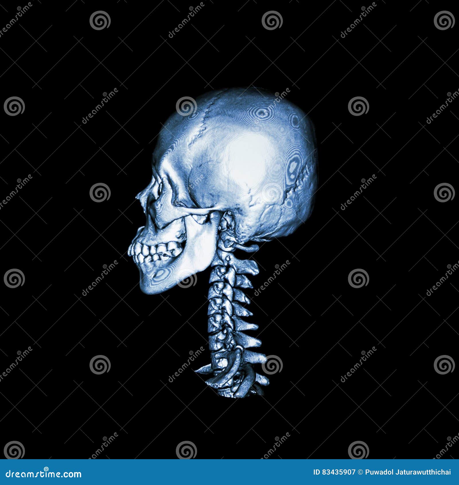 CT Scan with 3D Image of Normal Human Skull and Cervical Spine .lateral ...
