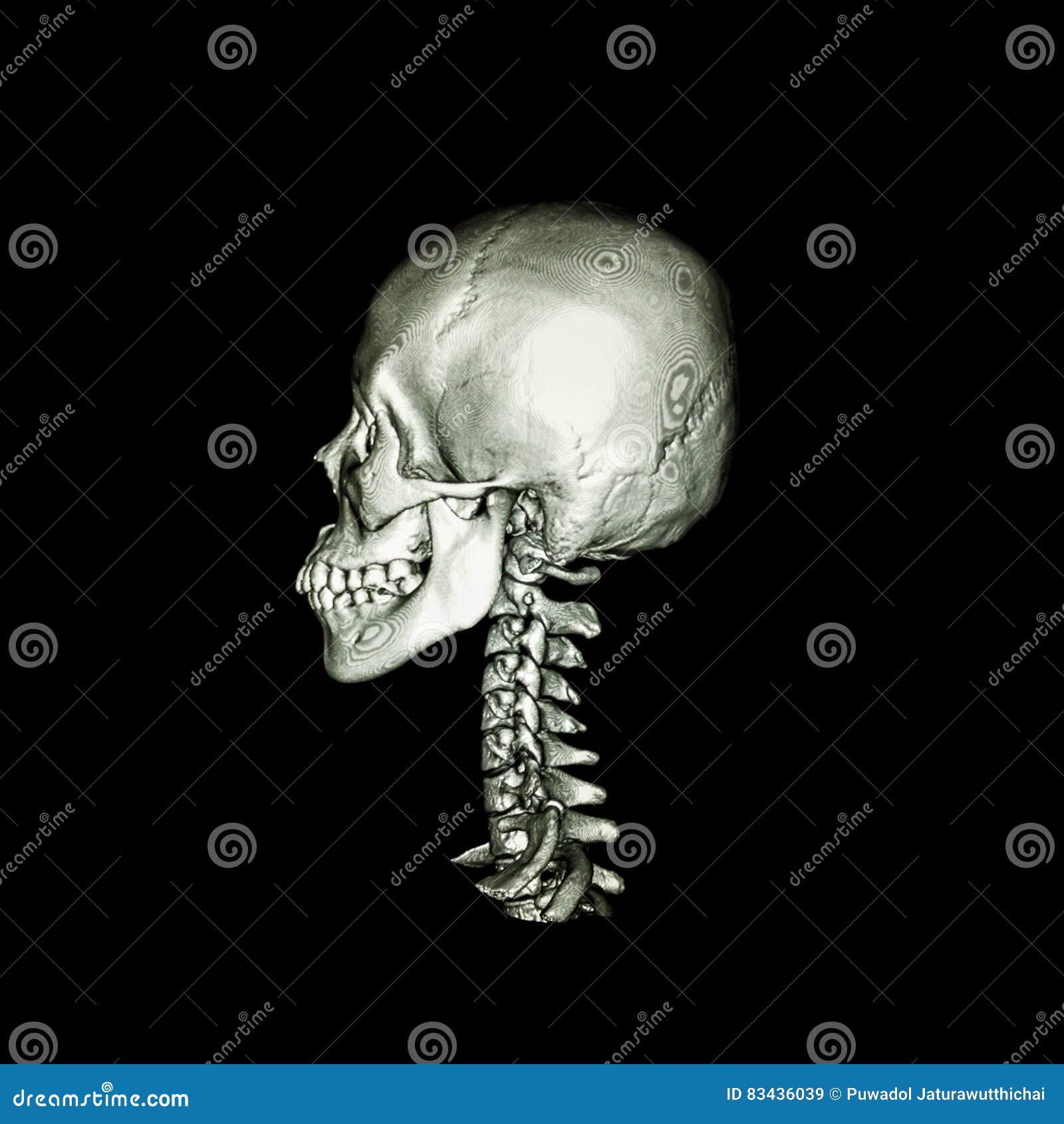 CT Scan with 3D Image of Normal Human Skull and Cervical Spine .lateral ...