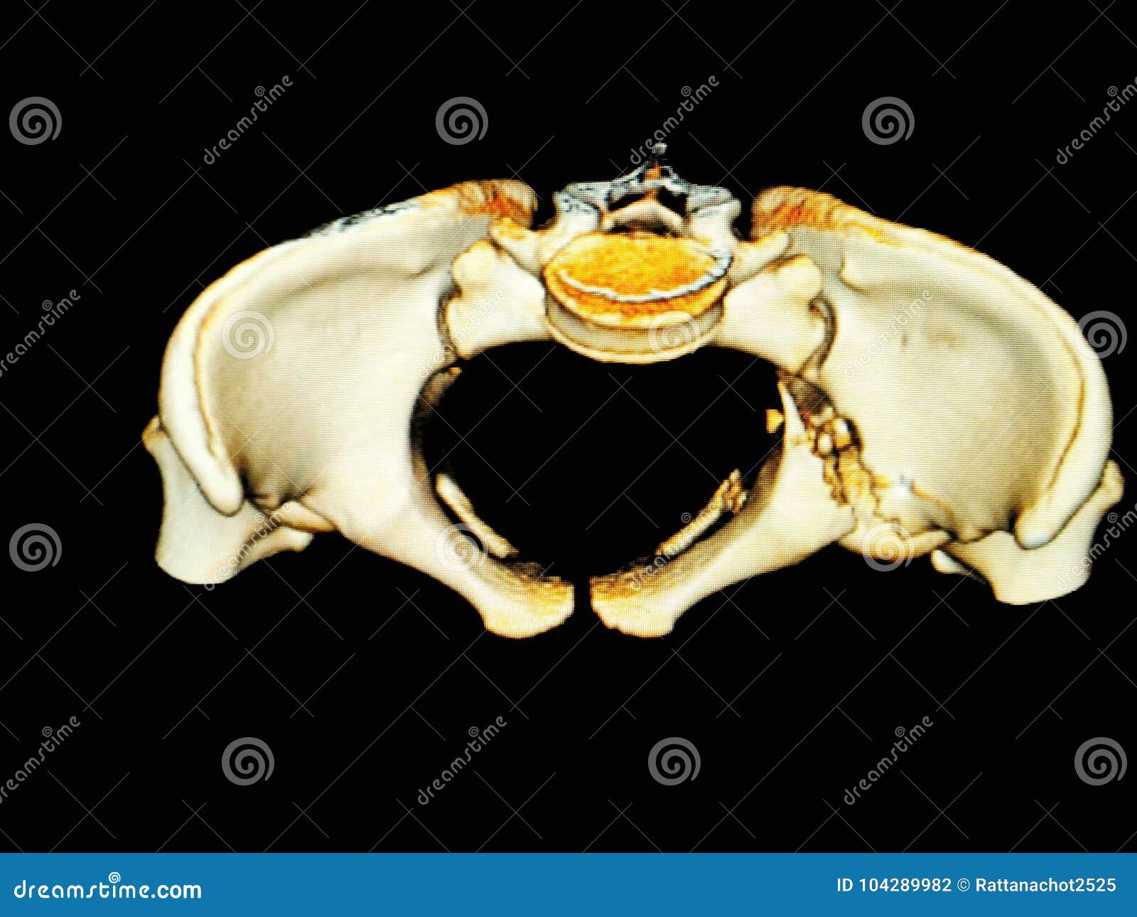 CT-scan 3D Pelvis stock photo. Image of ctscan, pelvis - 104289982