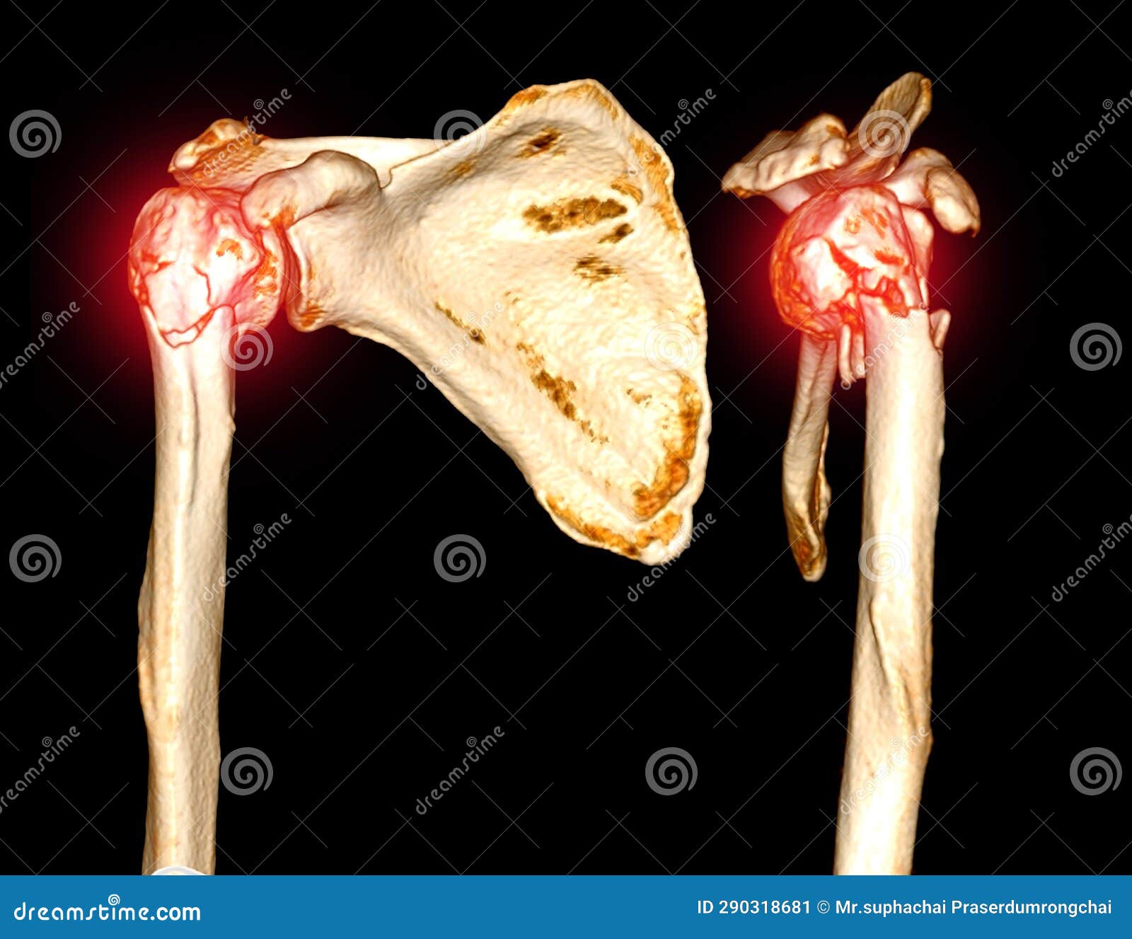CT Scan 3D Rendering Of Shoulder Joint Showing Fracture Head Of Humerus ... CT Scan 3D Rendering Of Shoulder Joint Showing Fracture Head Of Humerus ...