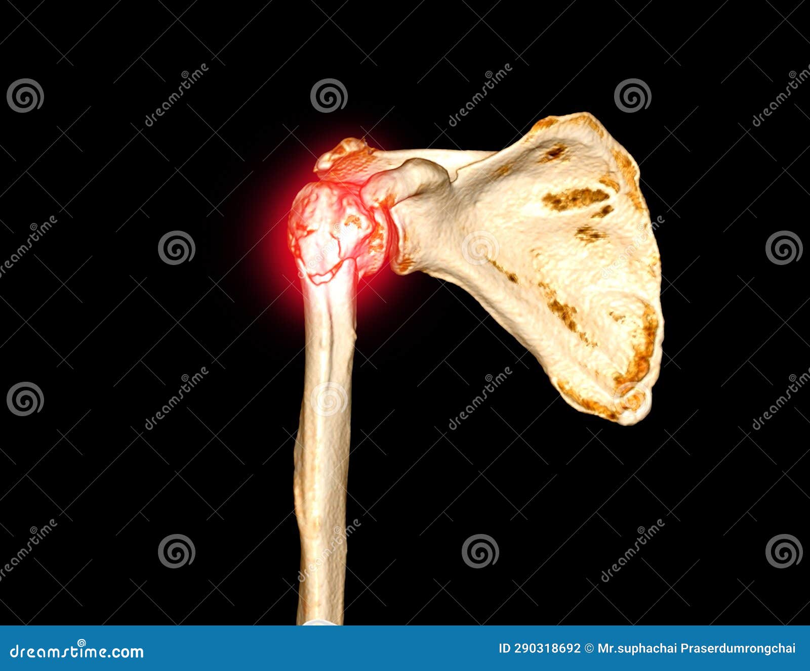 CT Scan 3D Rendering of Shoulder Joint Showing Fracture Head of Humerus ... CT Scan 3D Rendering of Shoulder Joint Showing Fracture Head of Humerus ...