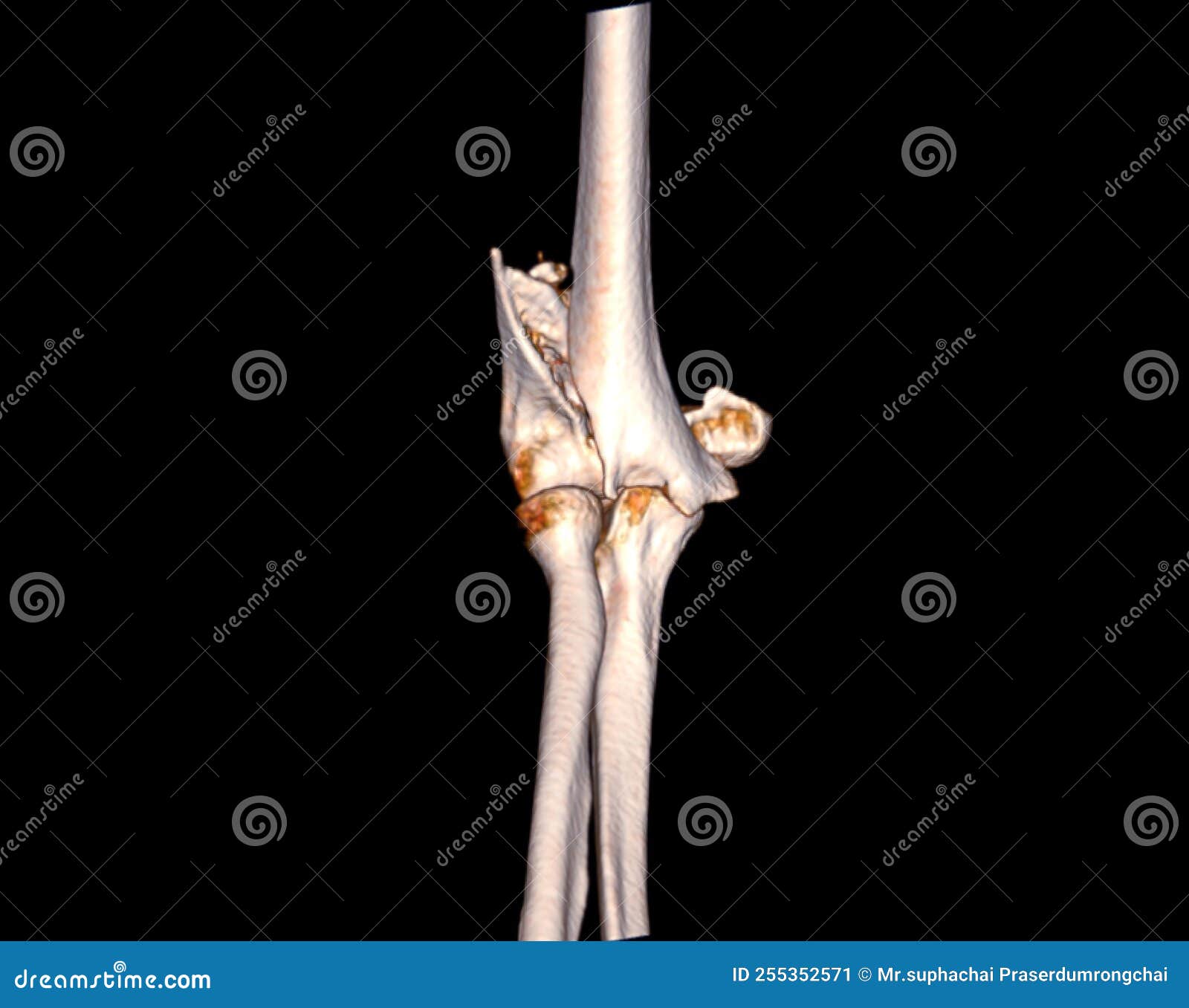 Ct Scan Of Elbow Joint Stock Illustration Illustration Of Doctor 255352571