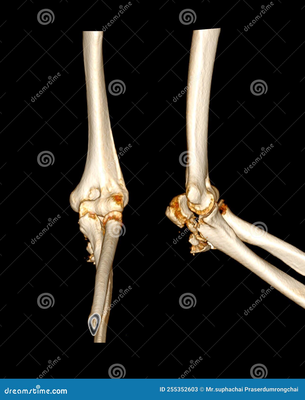 CT scan of elbow joint stock illustration. Illustration of structure ...