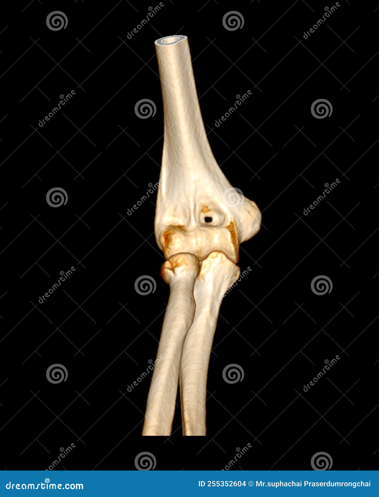 CT scan of elbow joint stock illustration. Illustration of panicking ...