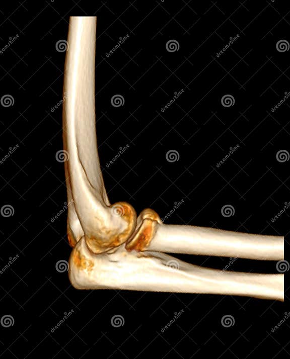 Ct Scan Of Elbow Joint Stock Illustration Illustration Of Upper 255352614