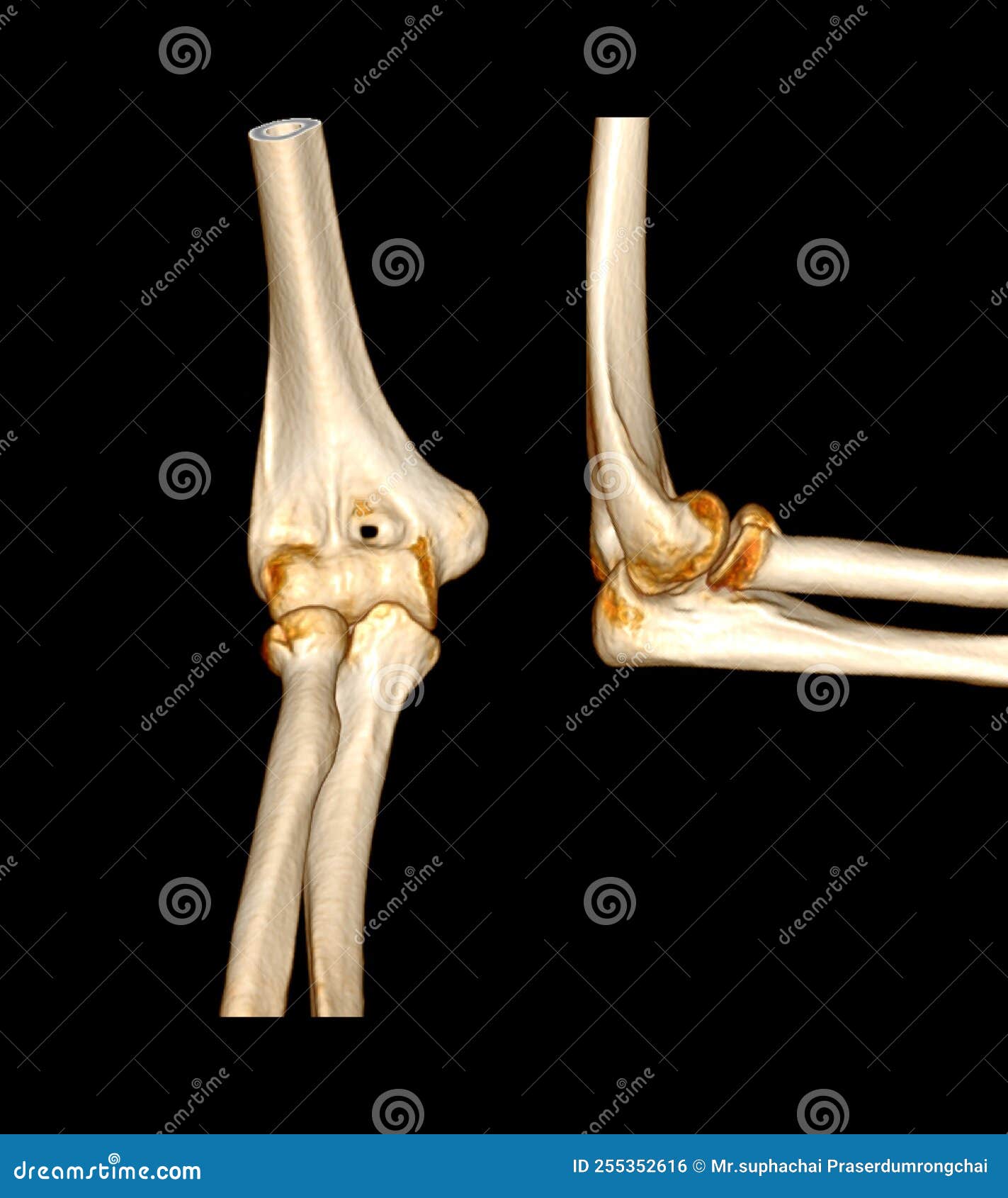CT scan of elbow joint stock illustration. Illustration of diagnosis ...