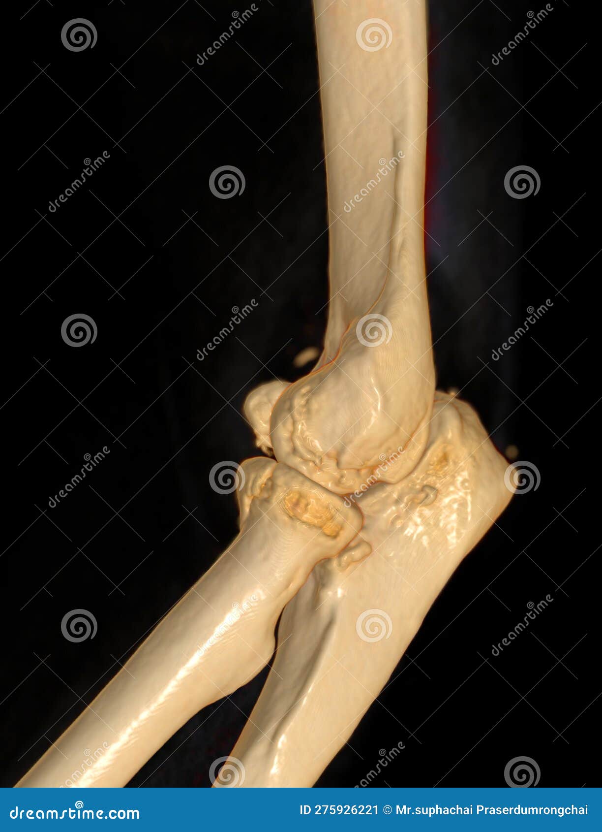 Ct Scan Of Elbow Joint 3d Rendering Stock Illustration Illustration Of Cartilage Inflammation