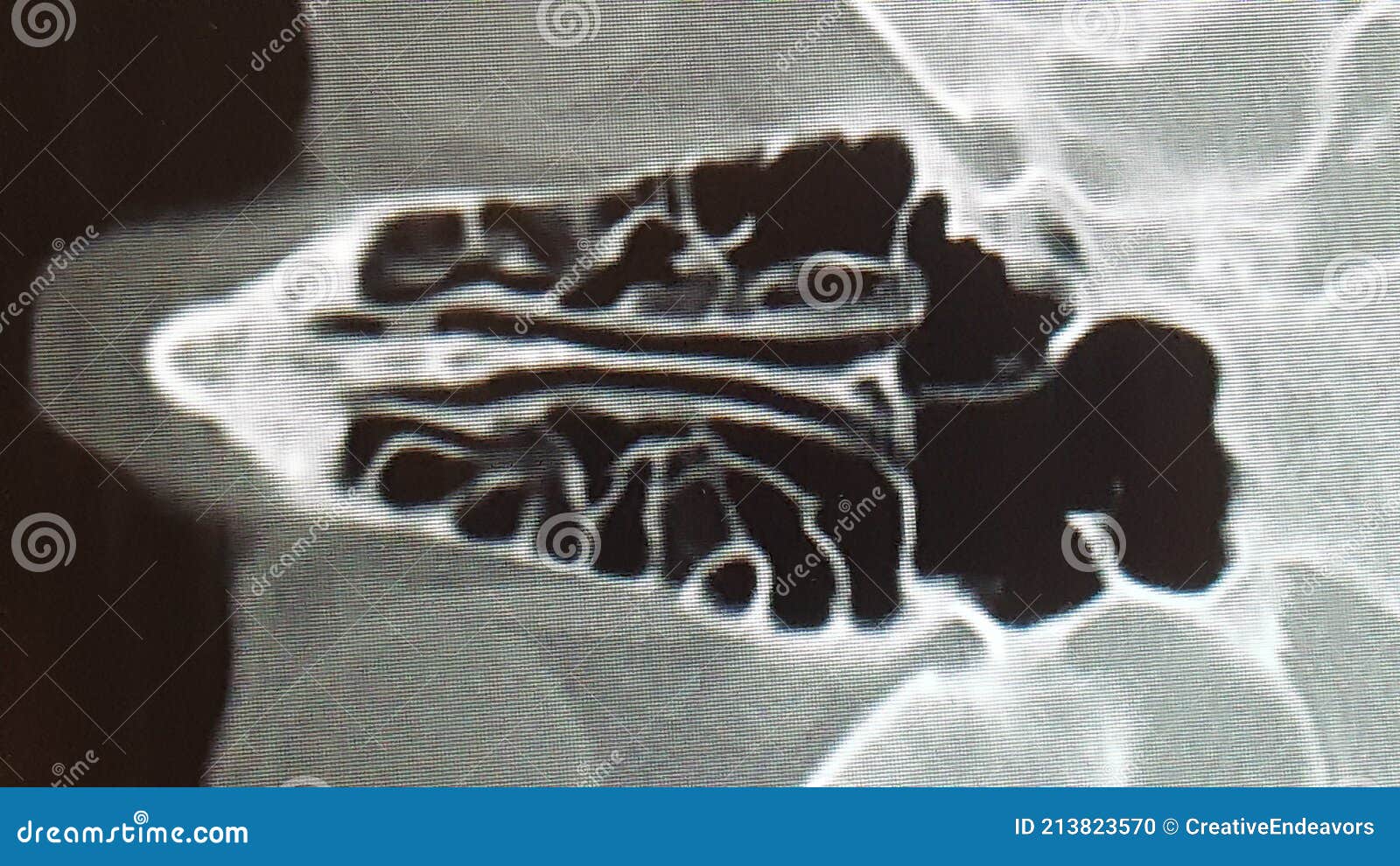 CT Scan of the Ethmoid Sinus Air Cells Stock Photo - Image of maze ...