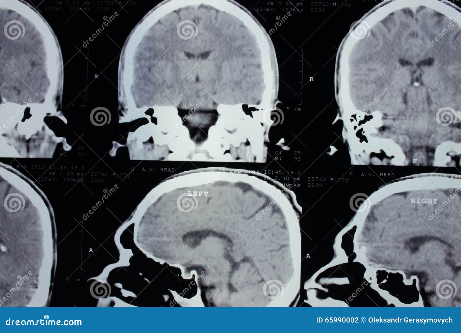 CT scan of the head stock photo. Image of tests, therapy - 65990002