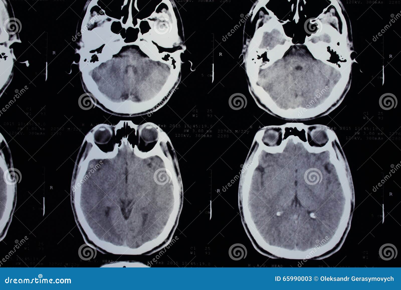 CT scan of the head stock image. Image of hospitals, cranium - 65990003