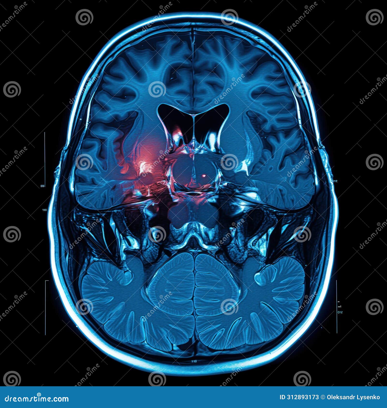 CT Scan of Human Brain Digital Image Stock Illustration - Illustration ...