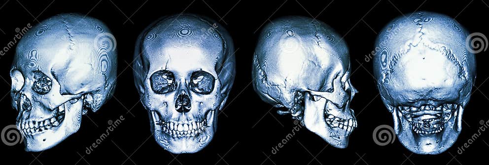 CT Scan of Human Skull and 3D Stock Photo - Image of neurosurgery ...