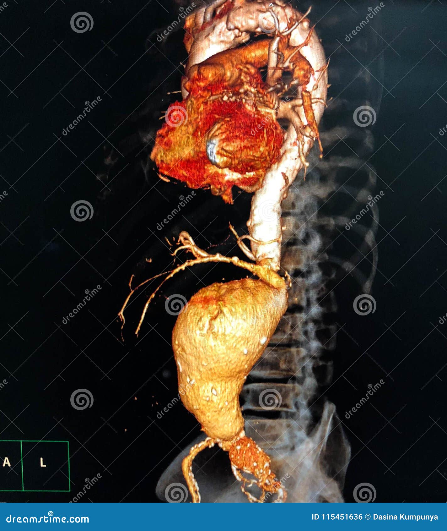 Abdominal aortic aneurysm stock photo. Image of heart - 115451636