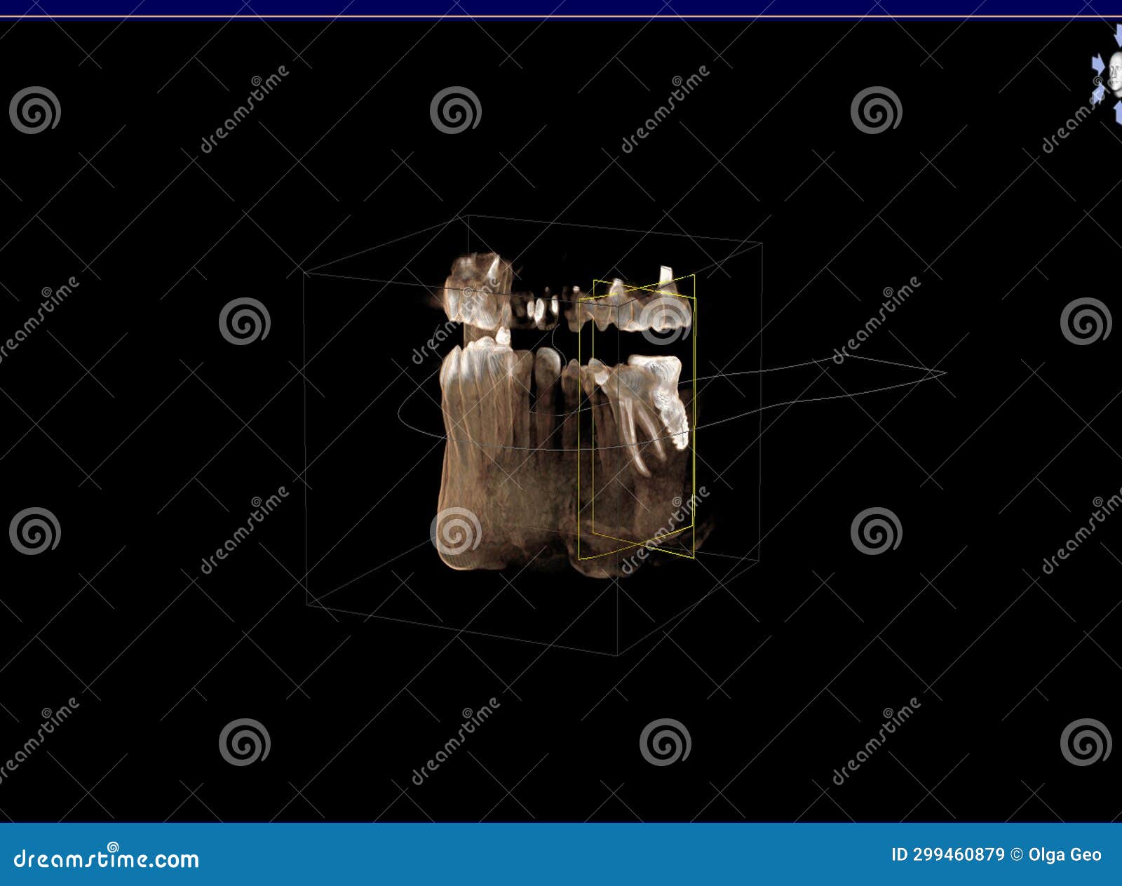 CT Scan of the Jaw with Dental Pin and Missing Tooth in Four Planes ...