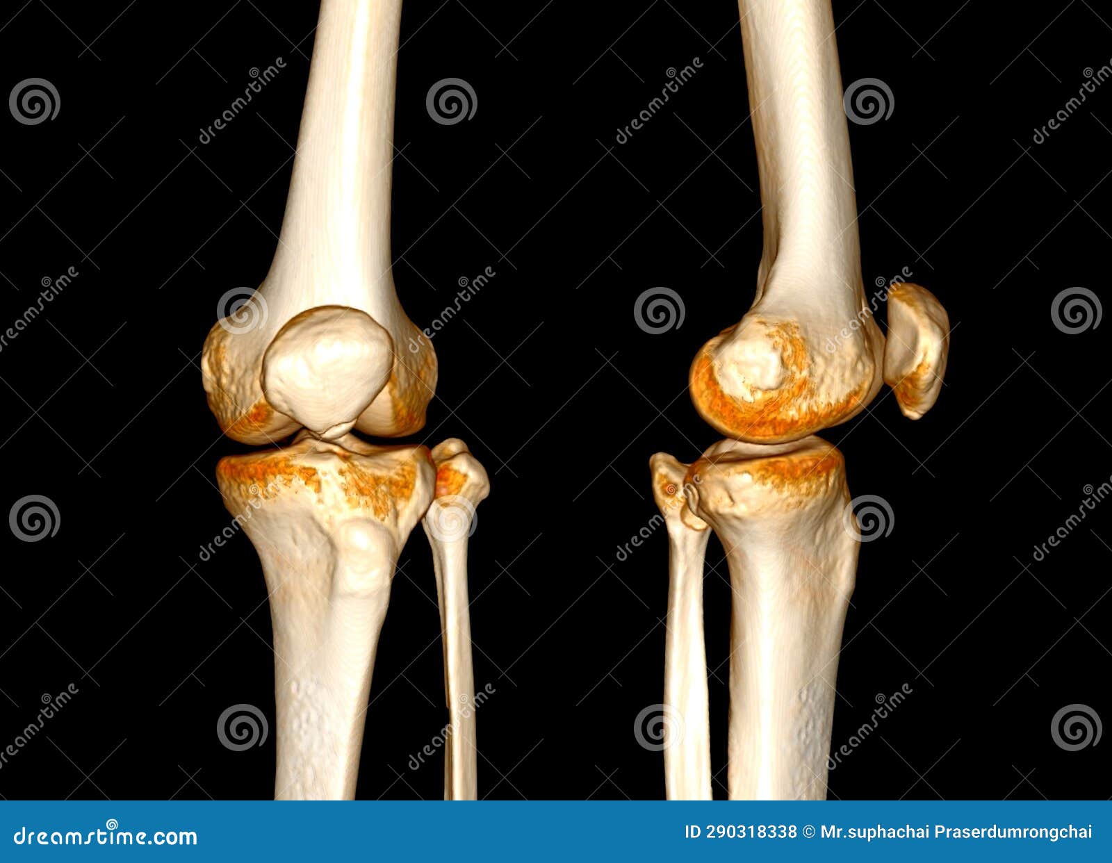 CT Scan Of Knee Joint Sagittal And Coronal In Case Fracture Patella ...