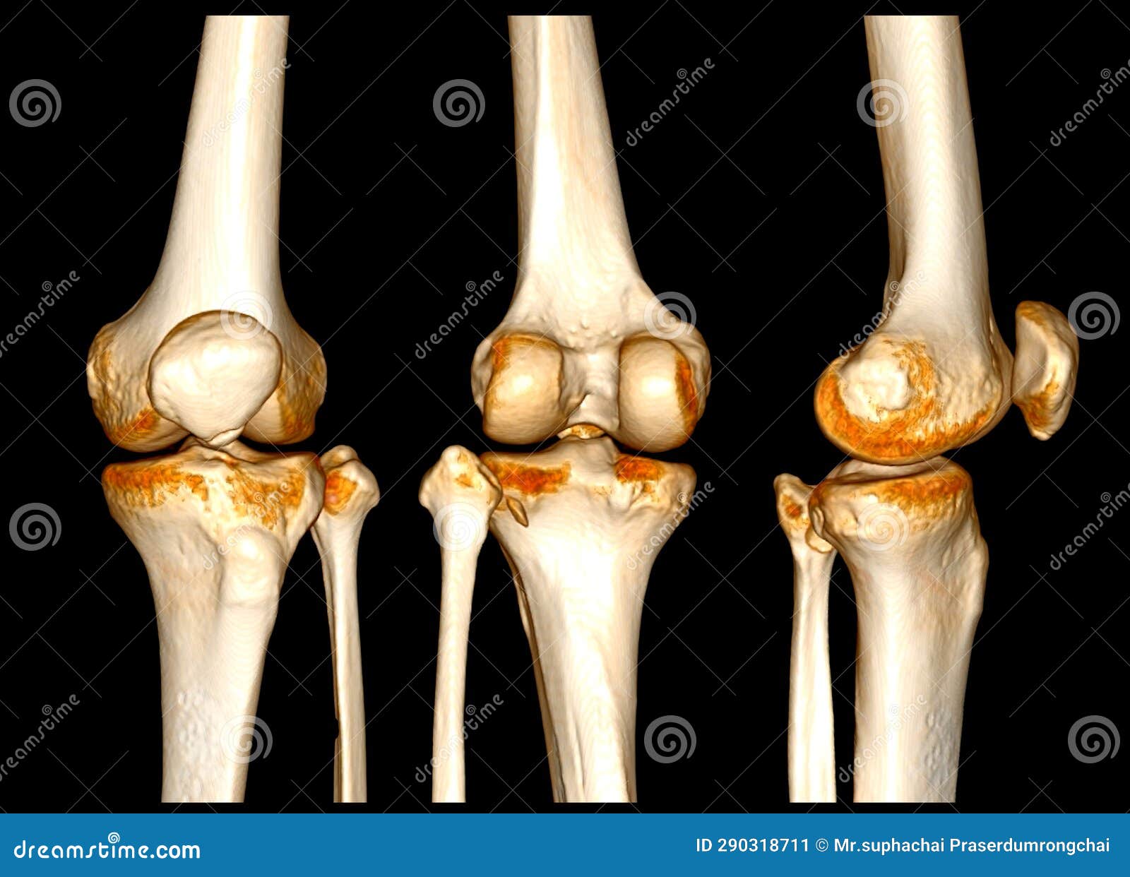 CT Scan Of Knee Joint Sagittal And Coronal In Case Fracture Patella ...