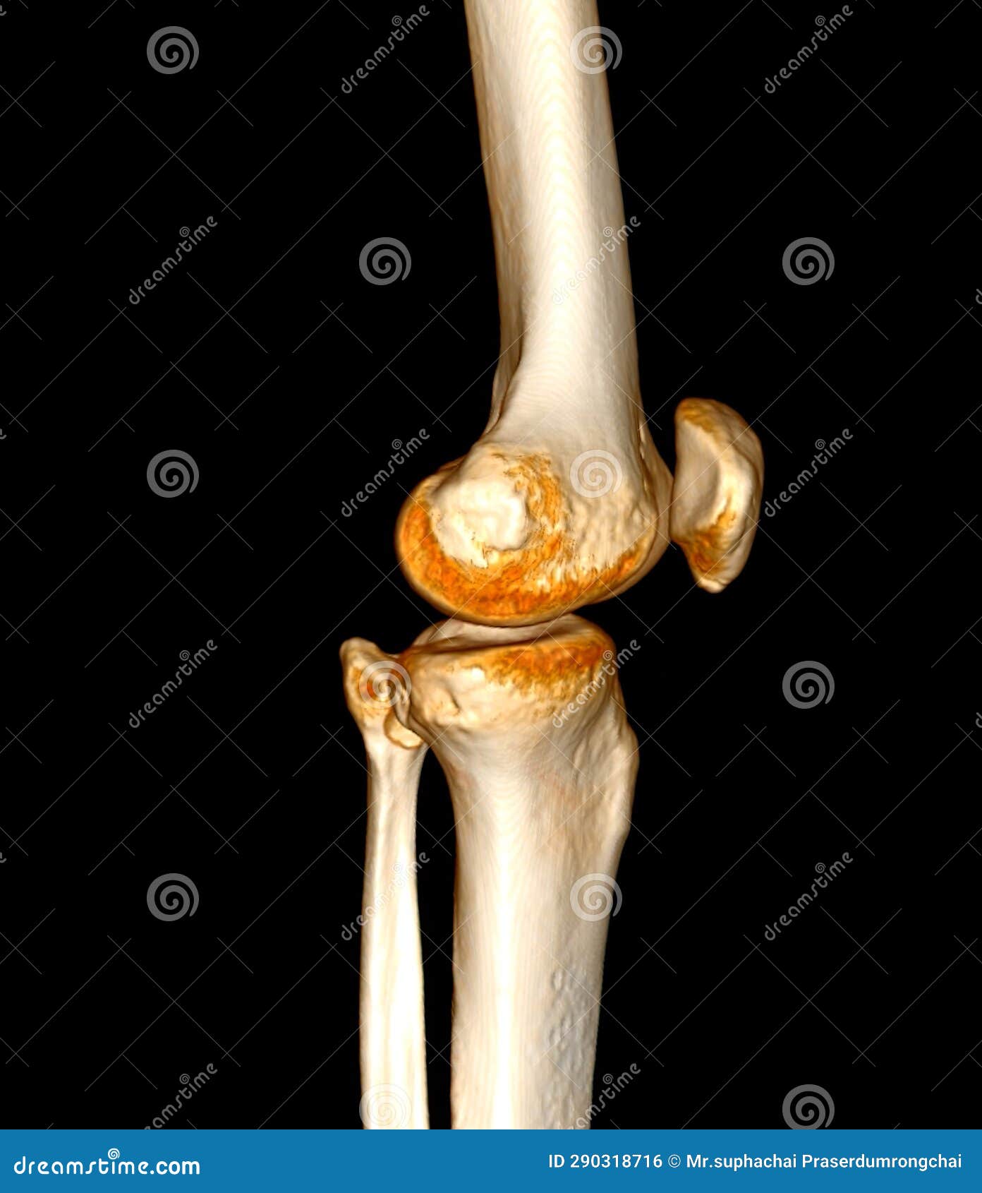 CT Scan Of Knee Joint Sagittal And Coronal In Case Fracture Patella ...