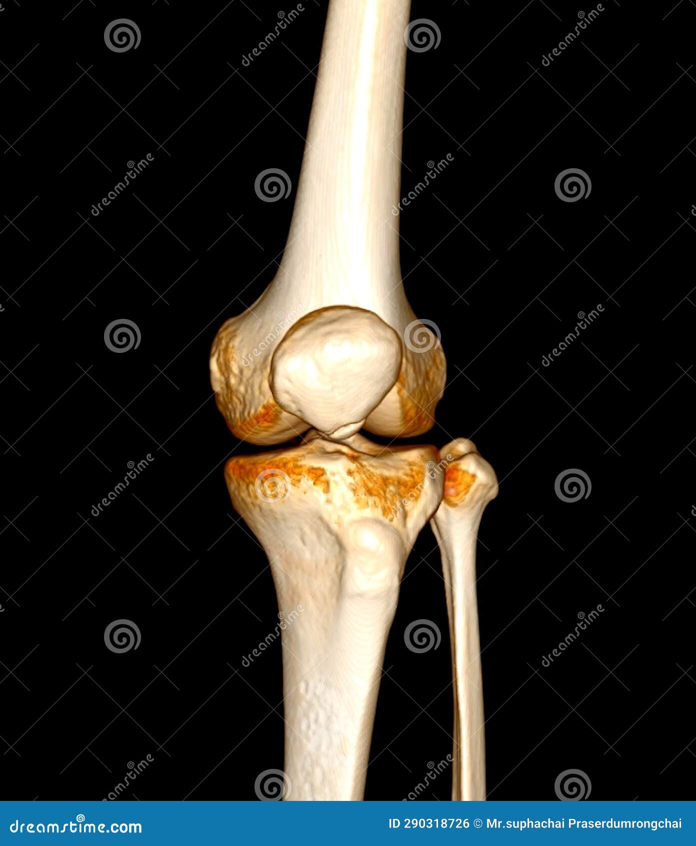 CT Scan Of Knee Joint Sagittal And Coronal In Case Fracture Patella ...