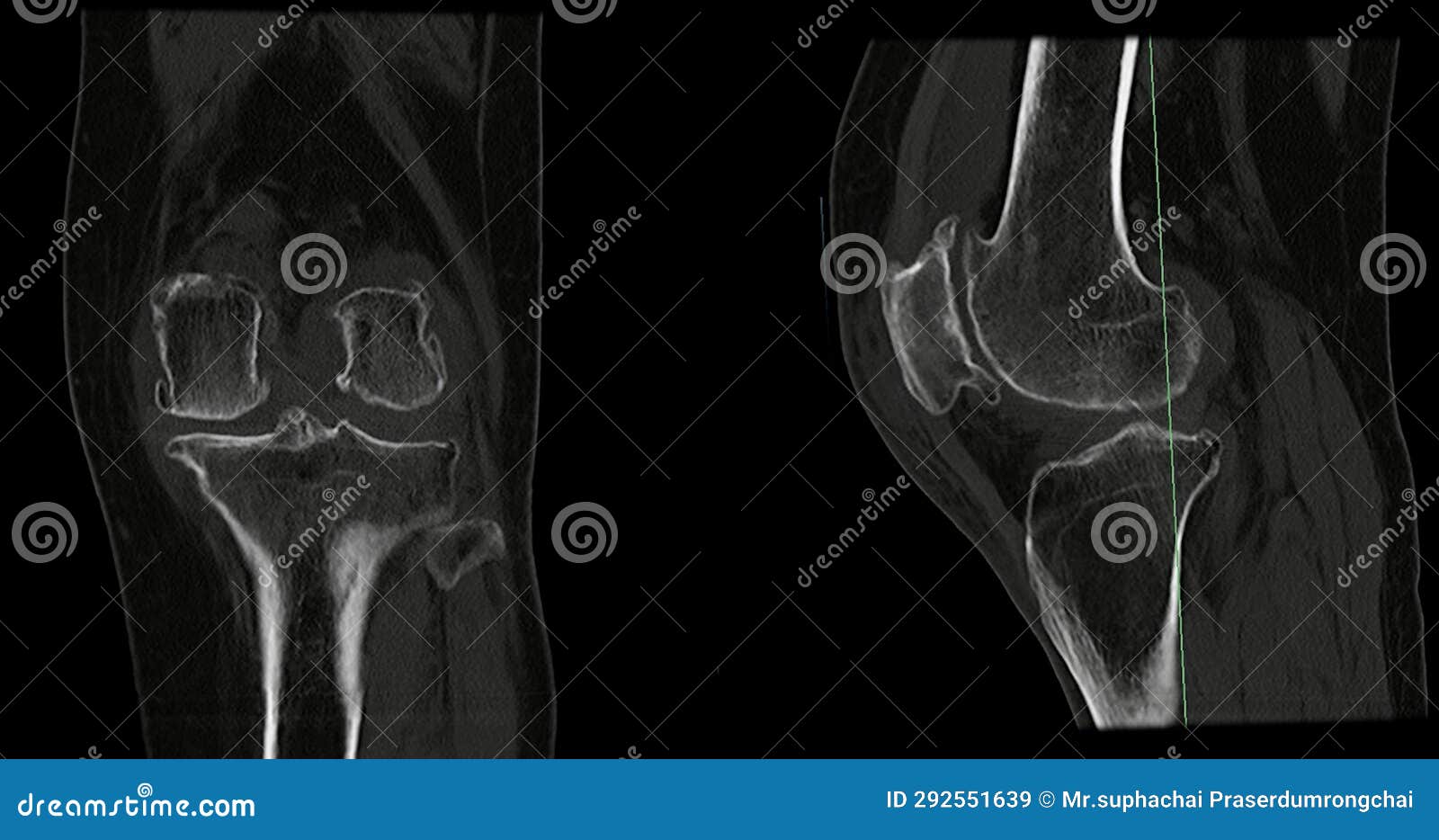 CT Scan Of Knee Joint Showing Fracture Of Distal Femur Bone Stock ...