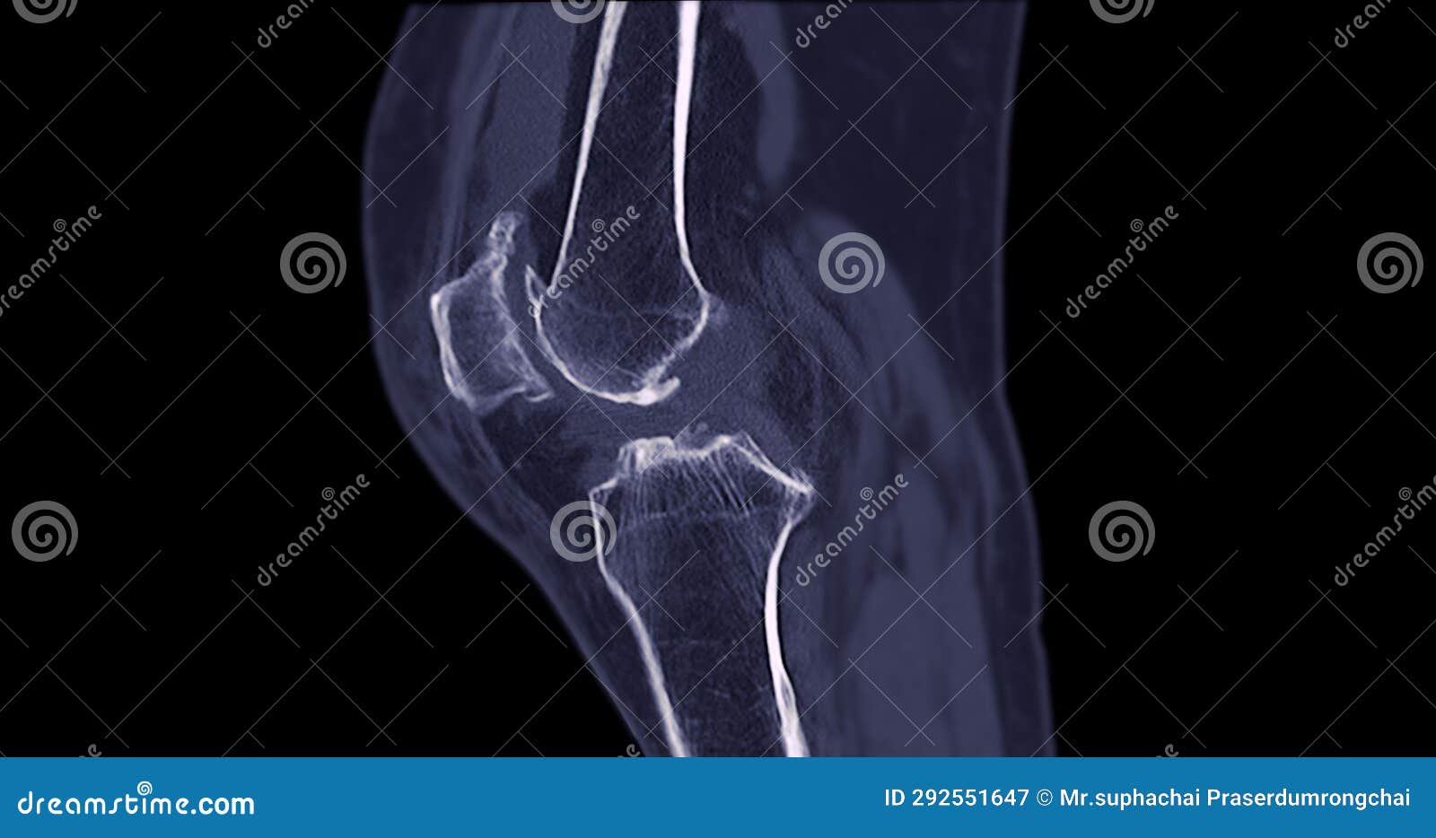 CT Scan Of Knee Joint Showing Fracture Of Distal Femur Bone Stock ...